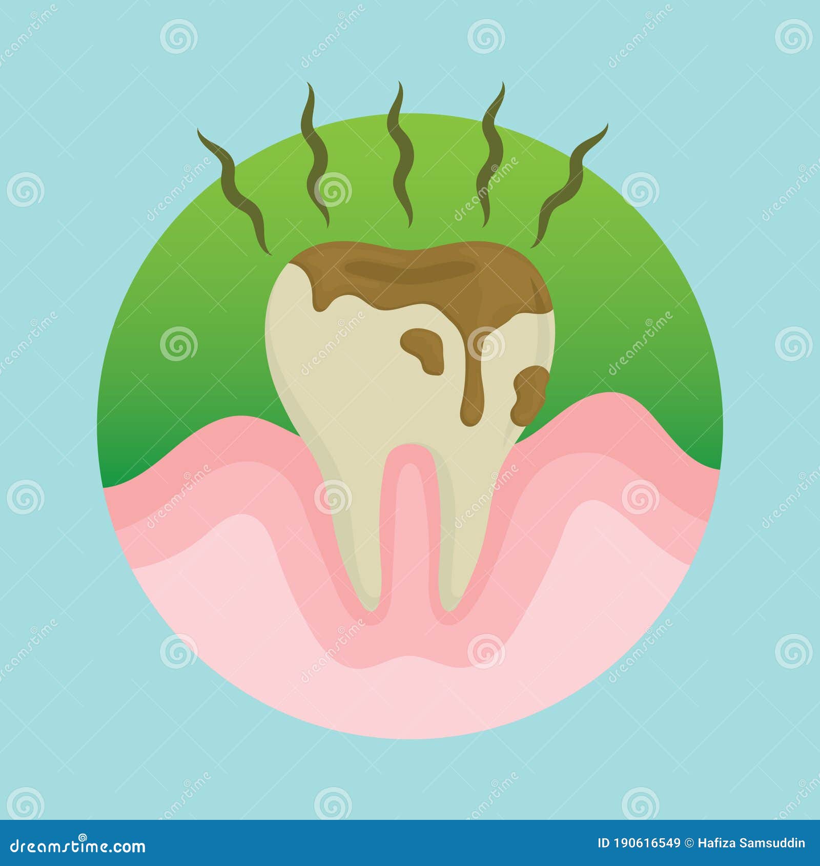 Tooth with Cavity. Vector Illustration Decorative Design Stock Vector ...