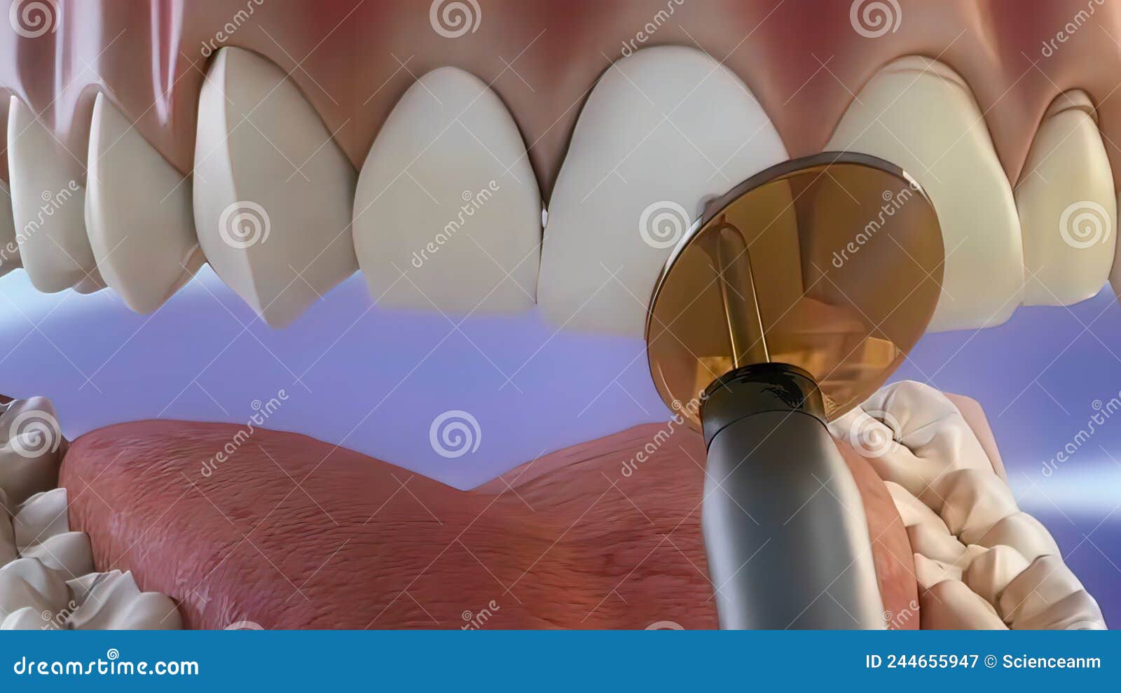 Tooth Coating Process, Drying with Adhesive Beam Stock Illustration ...