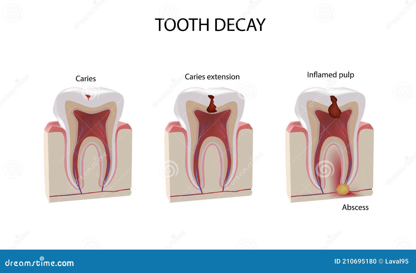 Tooth Damage Stages, Realistic Illustration, Dental Stock Vector ...