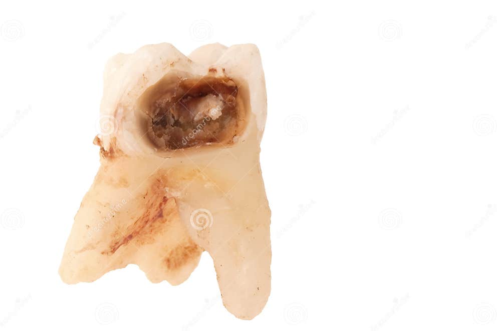 Tooth decay stock photo. Image of medical, health, isolated - 16007526