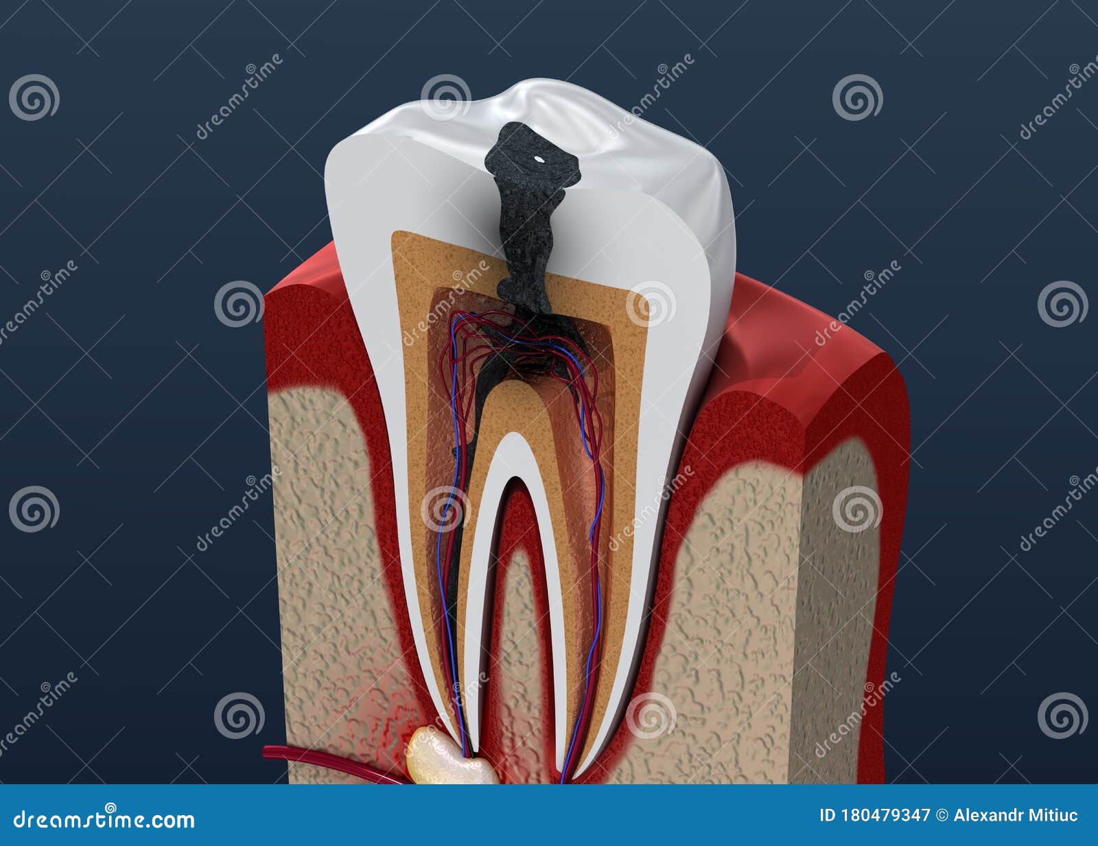 Tooth decay. illustration stock illustration. Illustration of bone ...