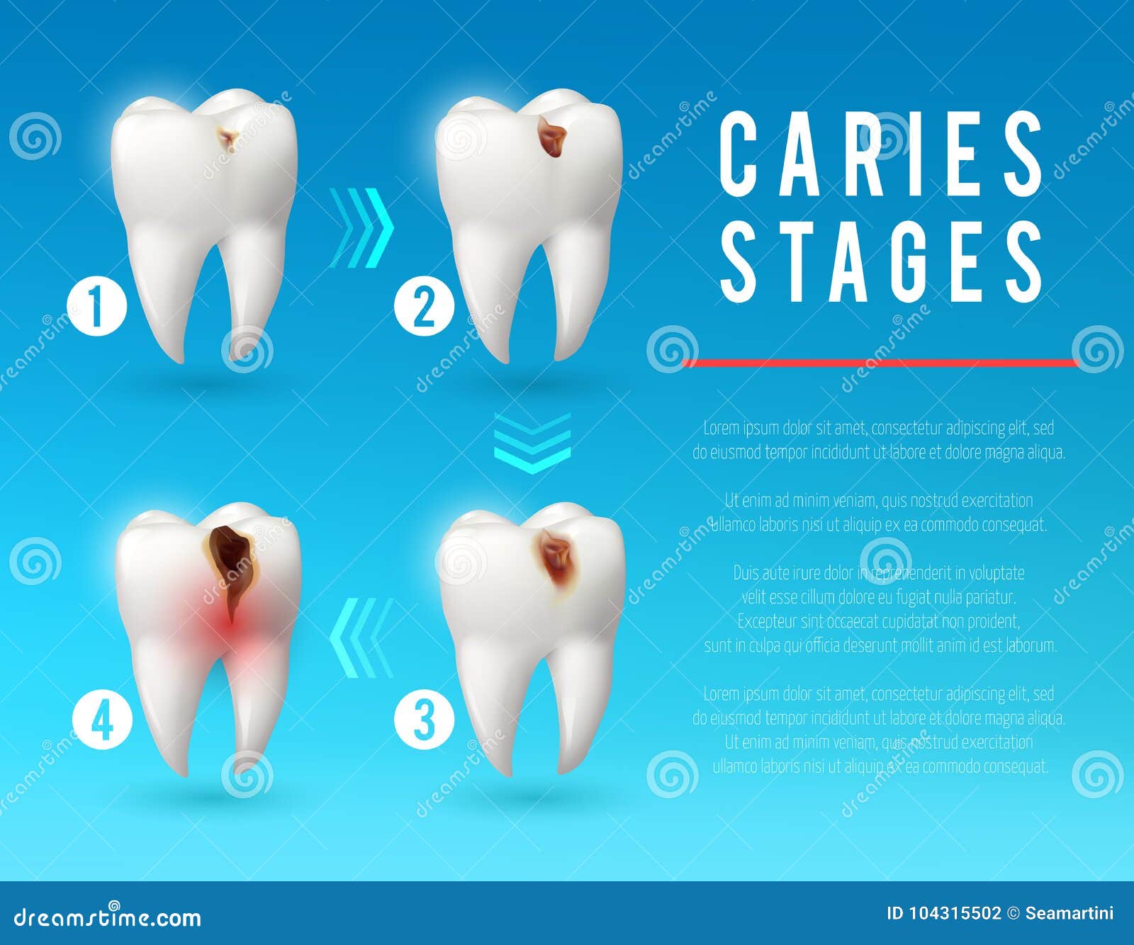Tooth Decay 3d Poster of Dental Caries Development Stock Vector ...