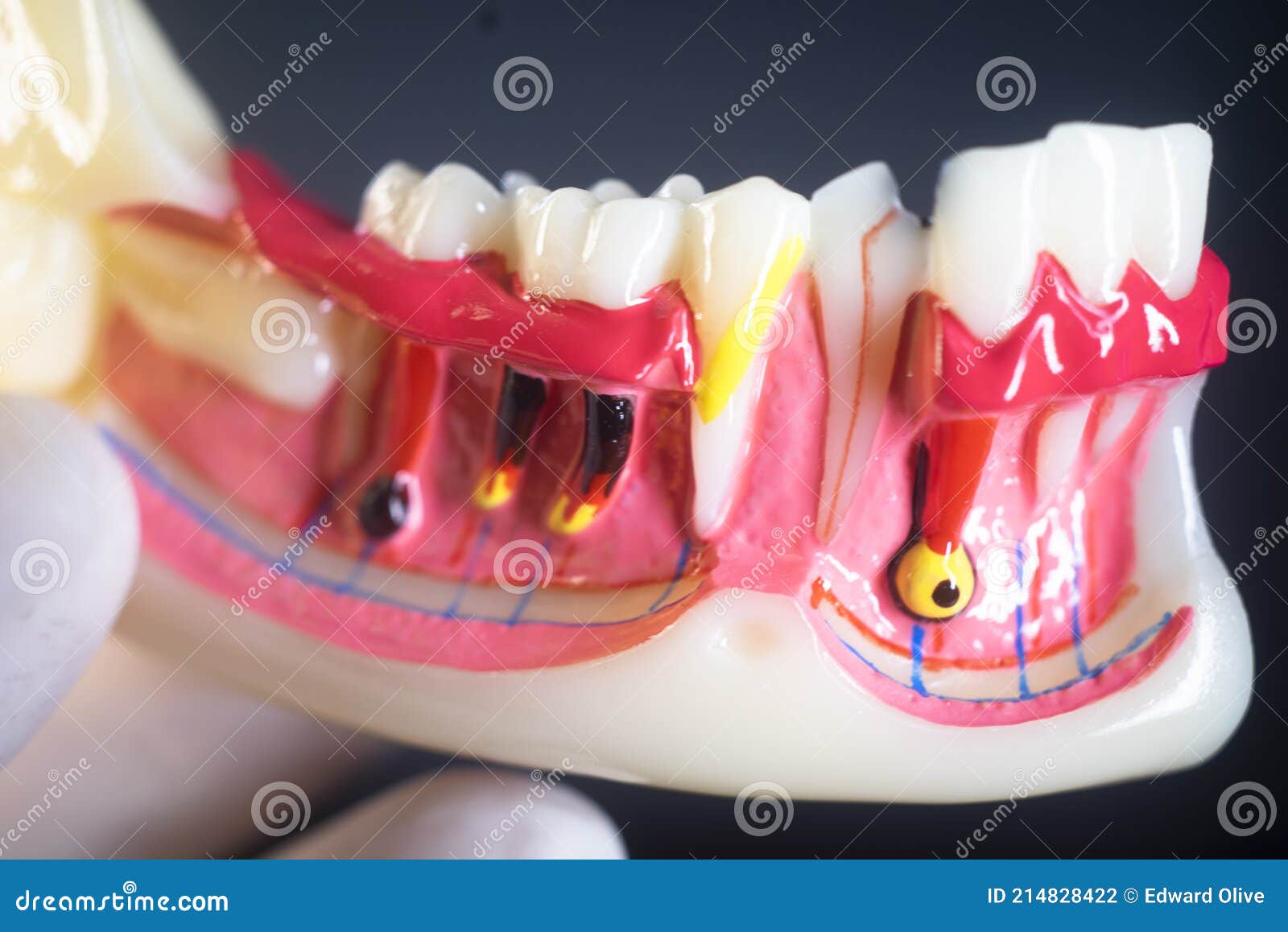 Tooth decay dental model stock photo. Image of health - 214828422