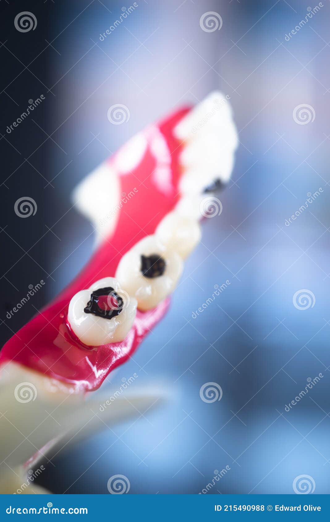 Tooth decay dental model stock photo. Image of enamel - 215490988