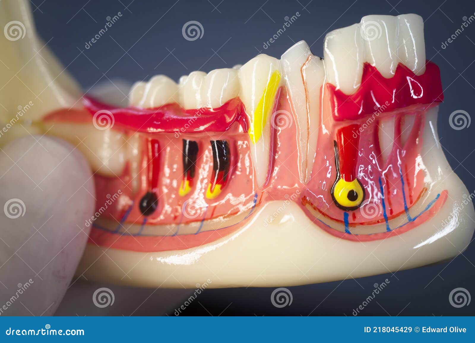 Tooth decay dental model stock image. Image of molar - 218045429