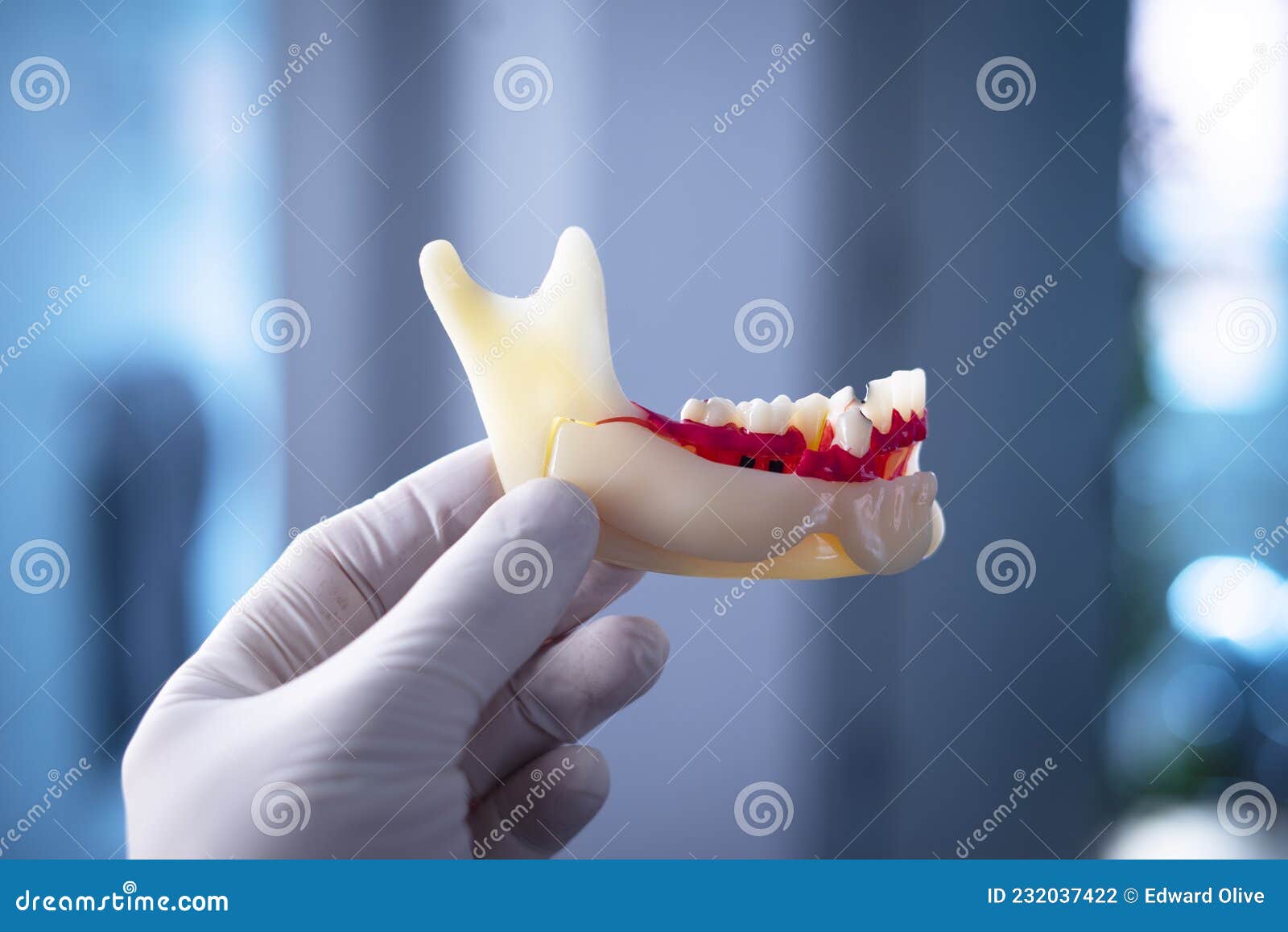 Tooth decay dental model stock photo. Image of clean - 232037422
