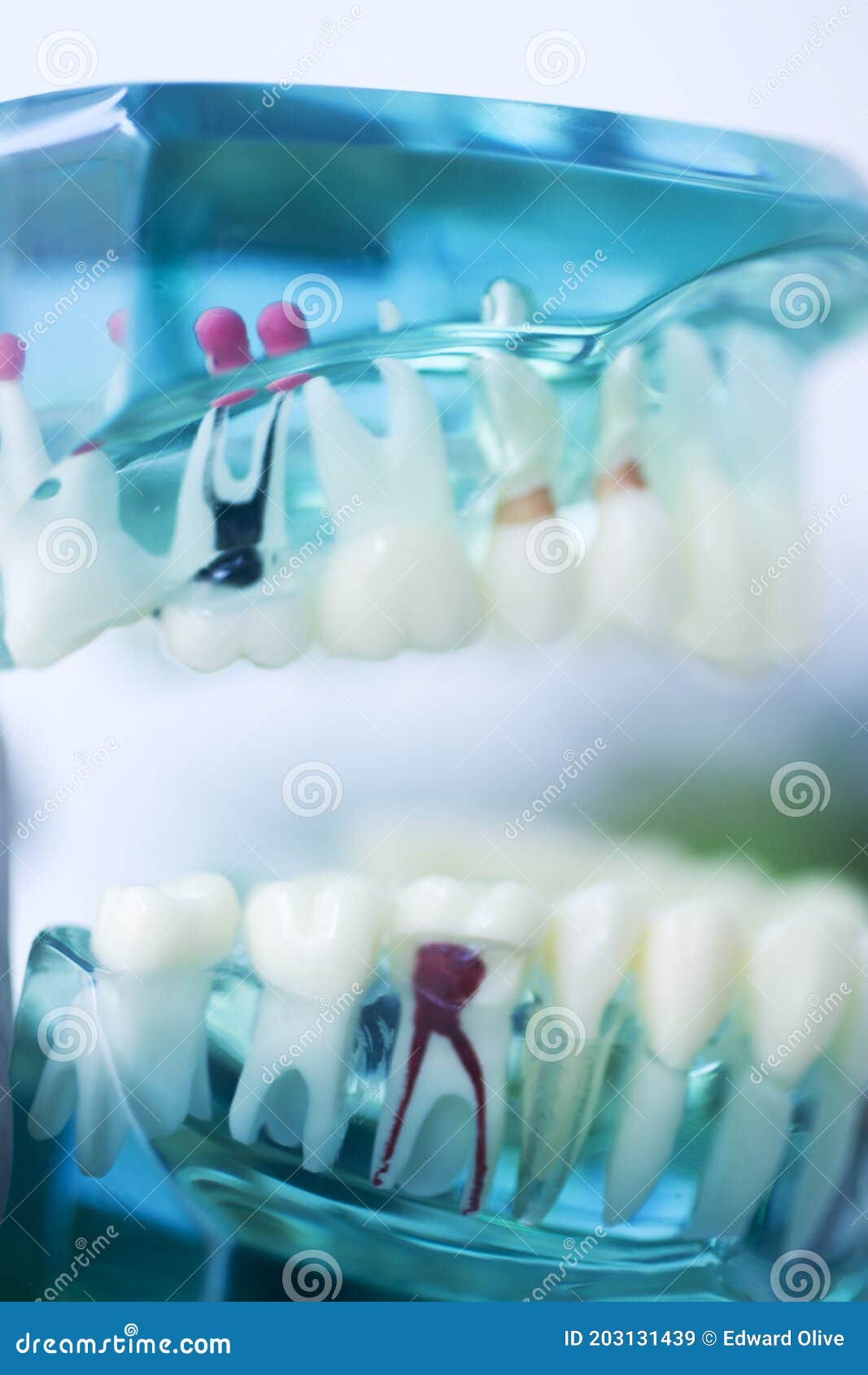 Tooth decay dental model stock image. Image of implantation - 203131439