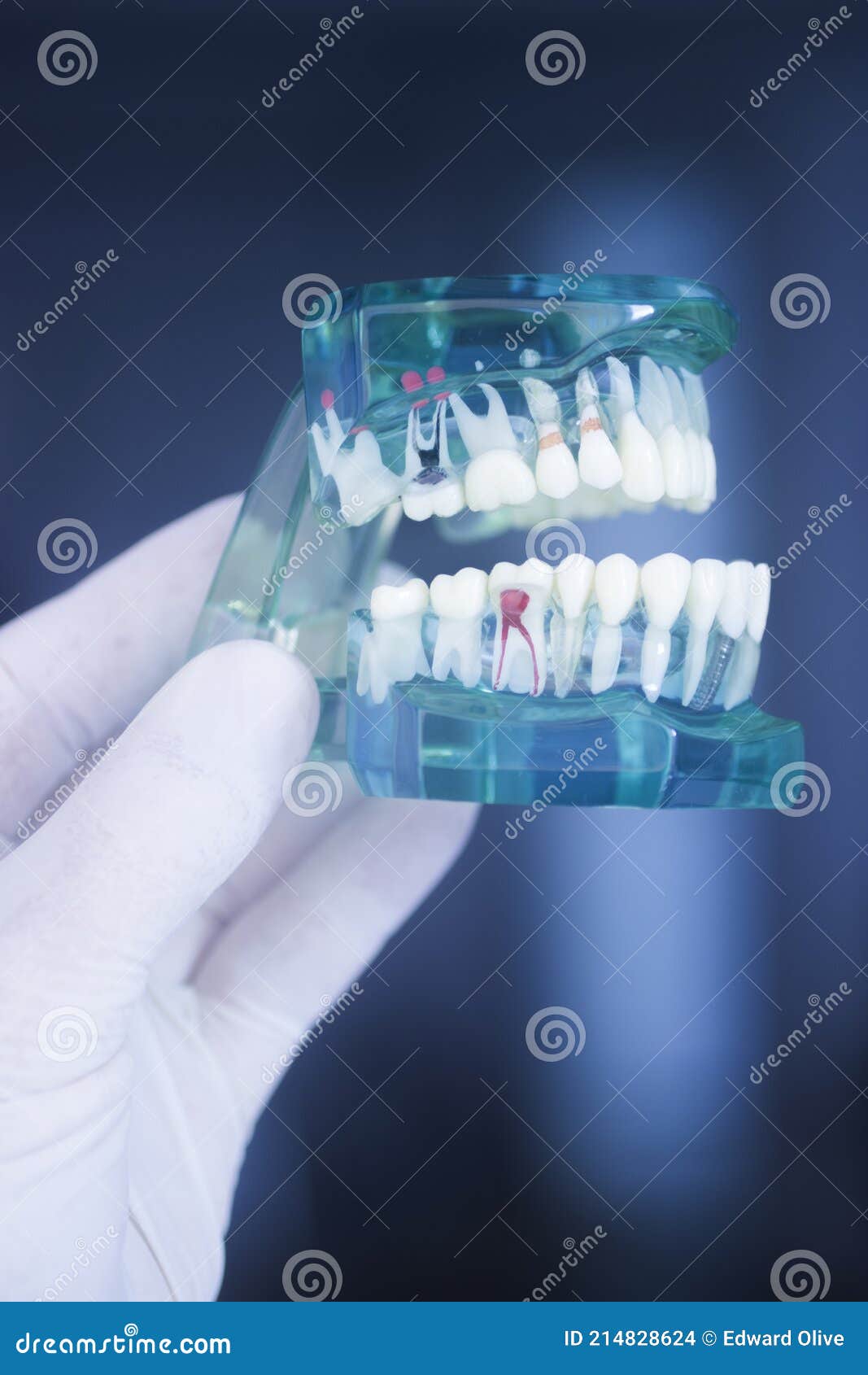 Tooth decay dental model stock photo. Image of orthodontist - 214828624