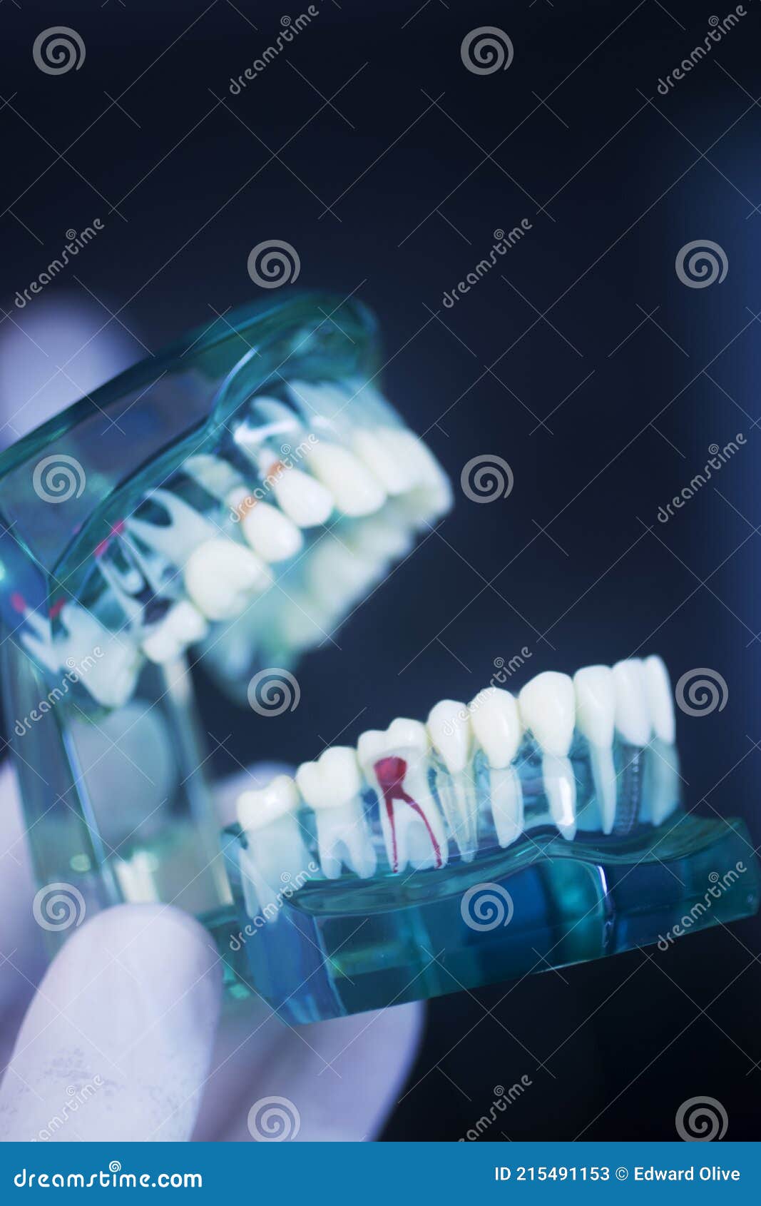 Tooth decay dental model stock image. Image of dentist - 215491153