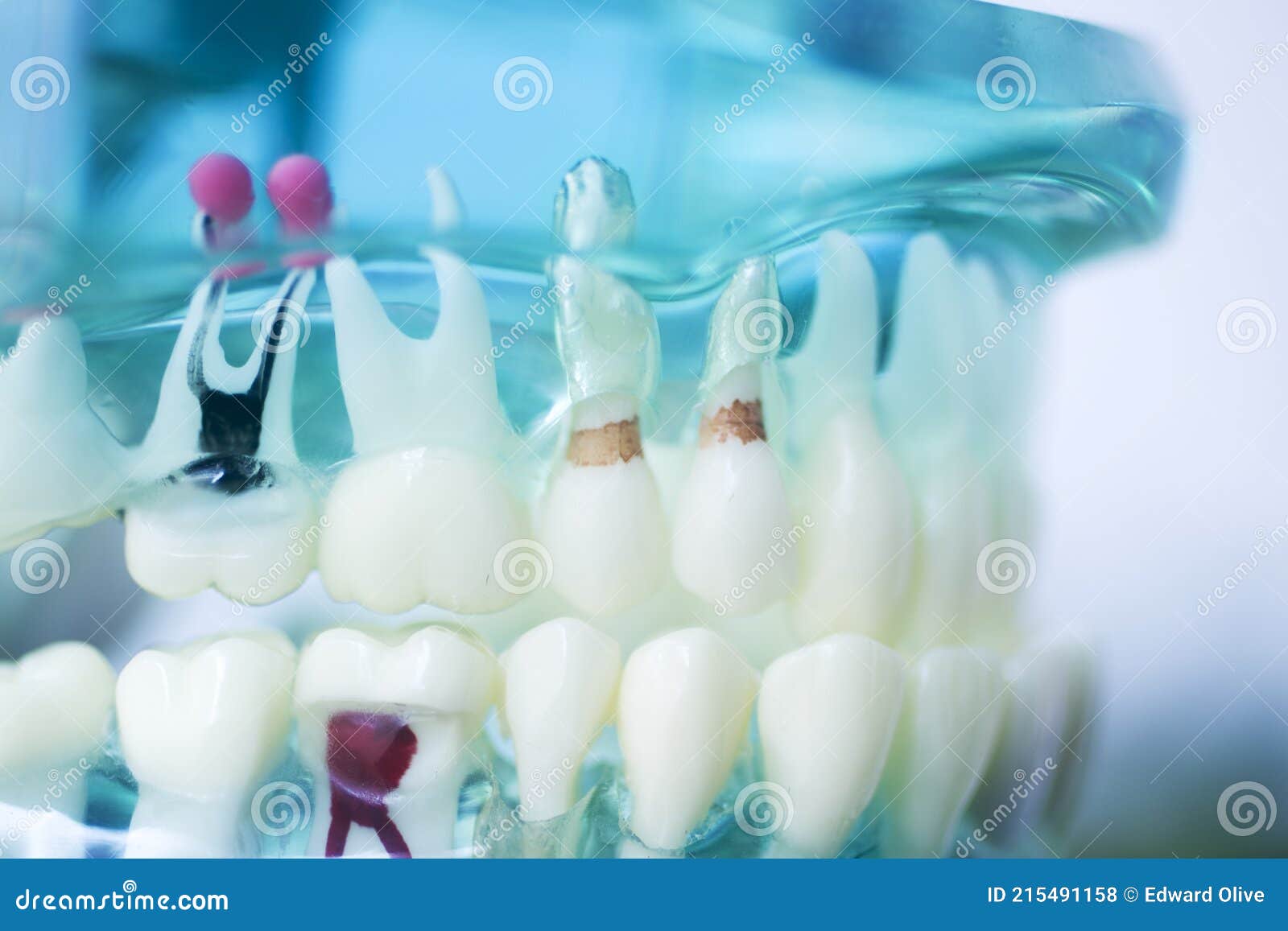 Tooth decay dental model stock photo. Image of orthodontist - 215491158