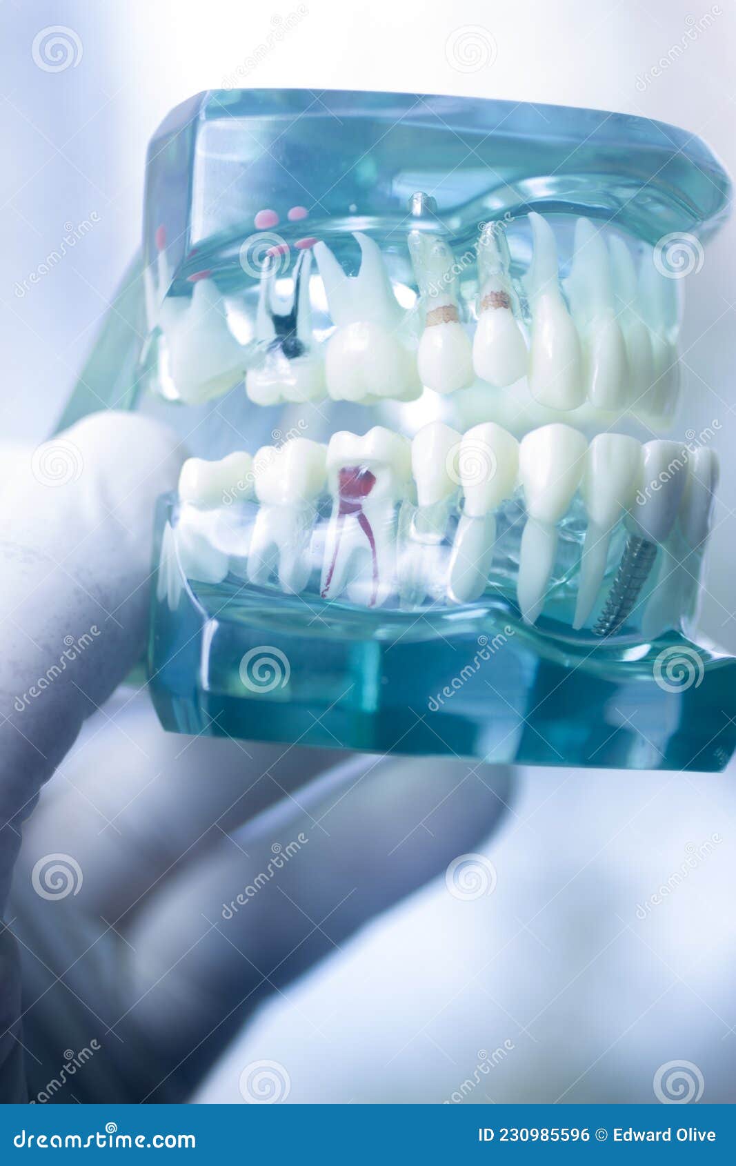 Tooth decay dental model stock photo. Image of mouth - 230985596