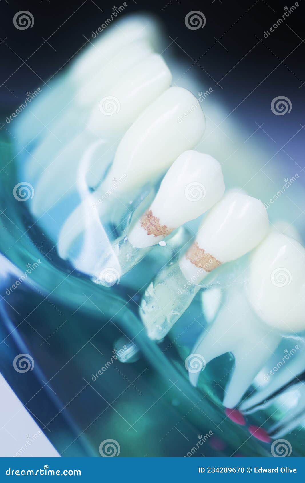 Tooth decay dental model stock photo. Image of dental - 234289670
