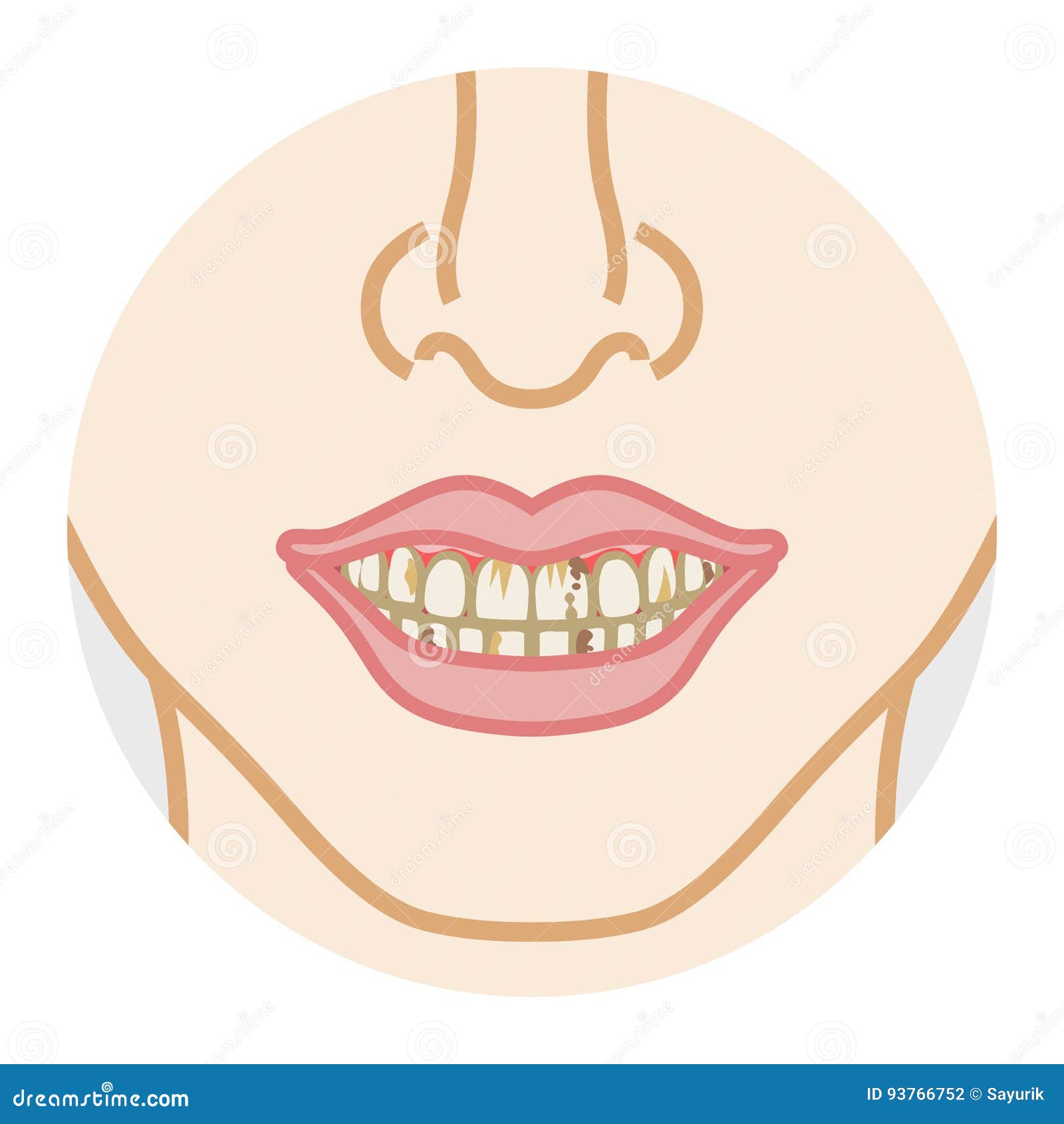 Tooth Decay and Dirty Teeth Stock Vector - Illustration of front ...