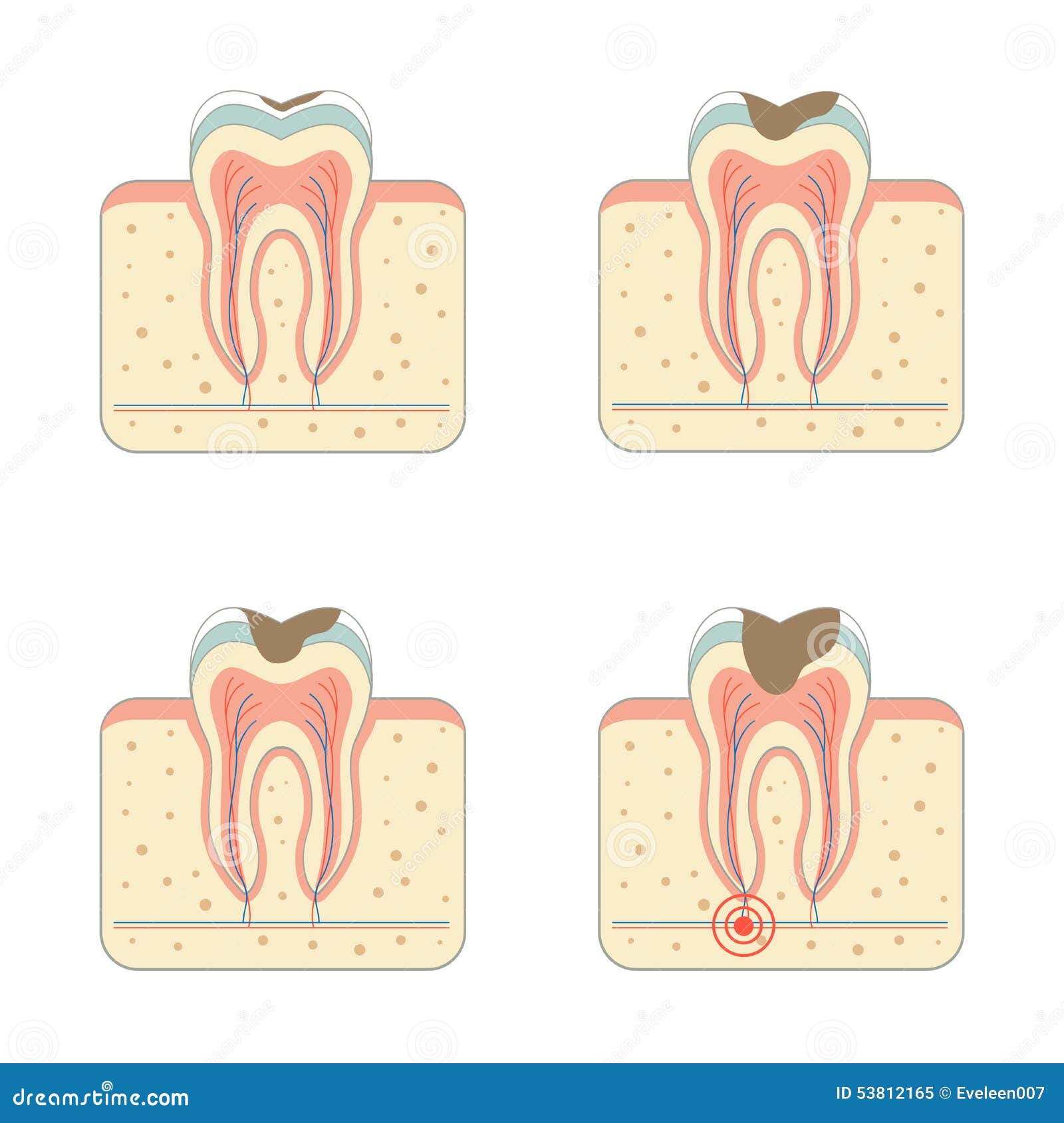 Tooth Decay With Health Problem Vector Illustration | CartoonDealer.com ...
