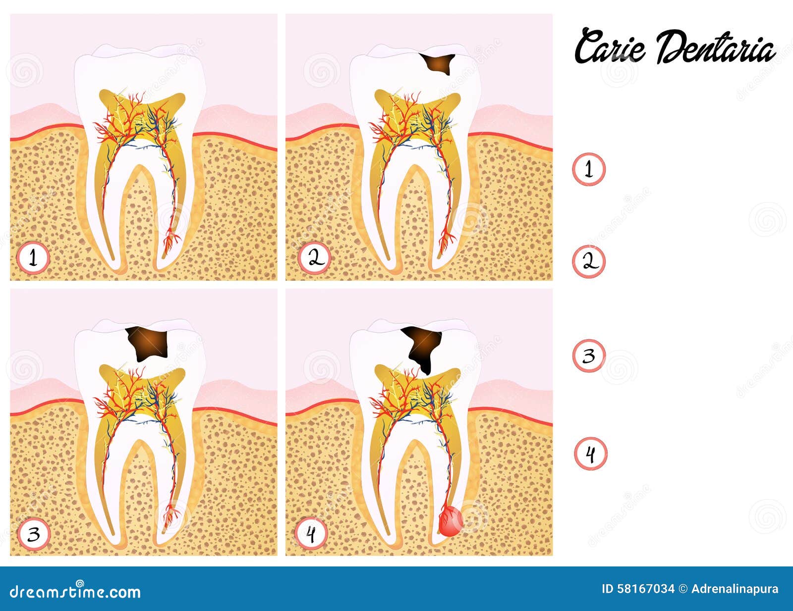 Tooth Decay Diagram