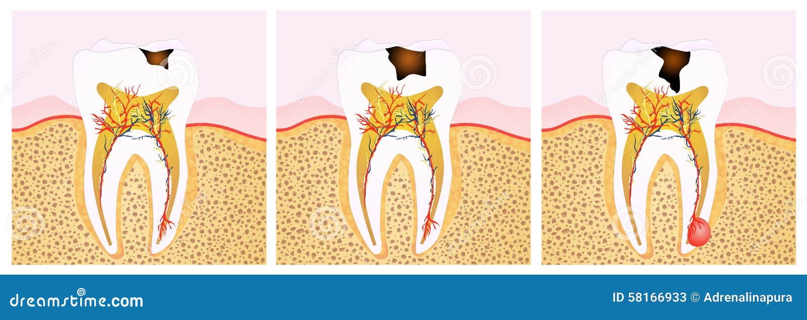 Tooth decay scheme stock illustration. Illustration of medicine - 58166933