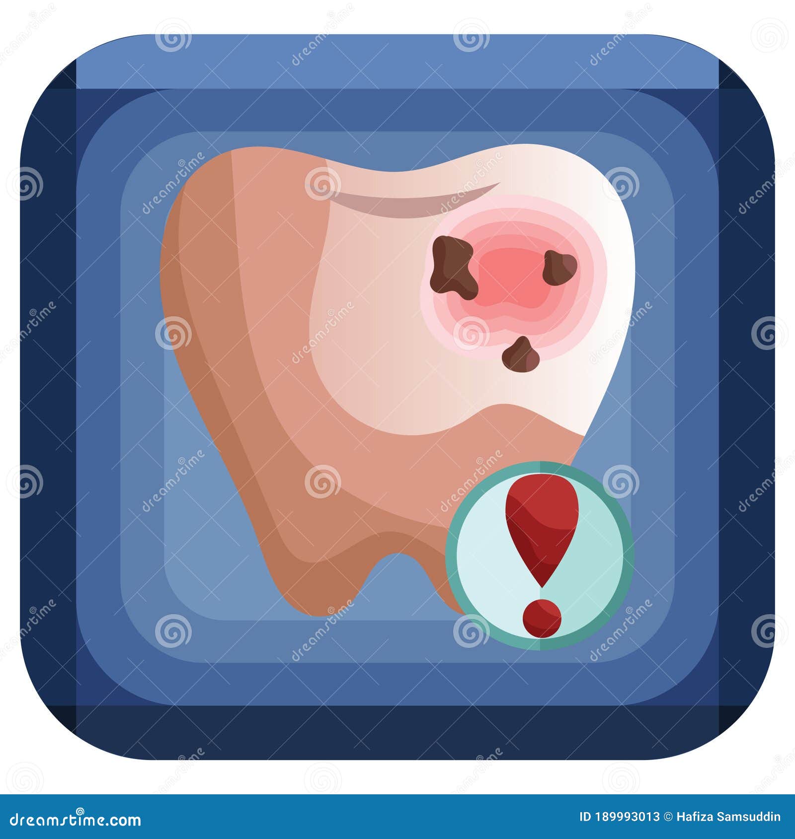 Tooth Decay. Vector Illustration Decorative Design Stock Vector ...