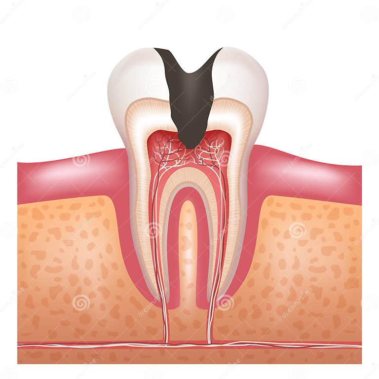 A Tooth with Deep Caries. Pulpitis Stock Illustration - Illustration of ...