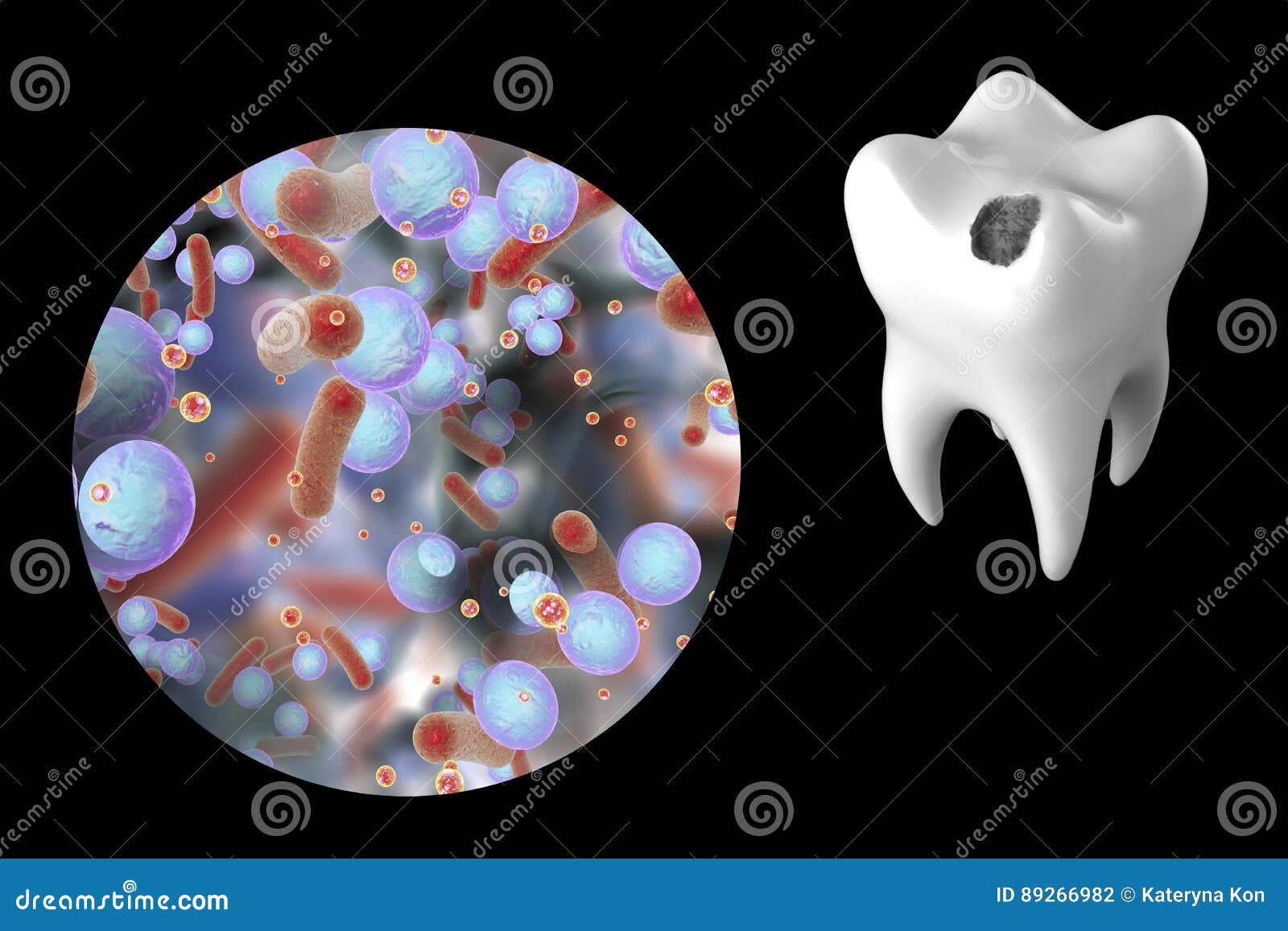 Tooth with dental caries stock illustration. Illustration of caries ...