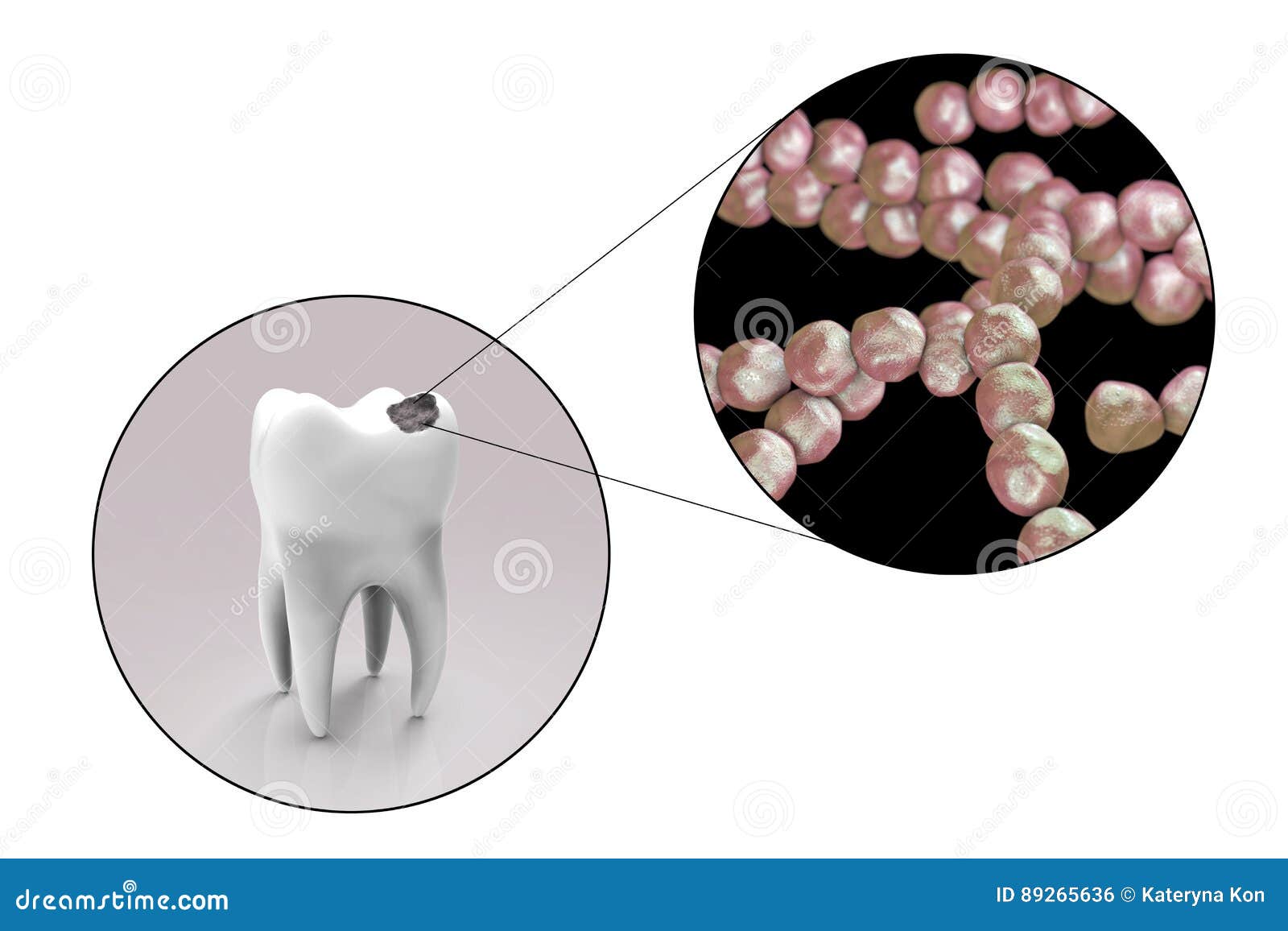 Tooth with dental caries stock illustration. Illustration of bacterium ...