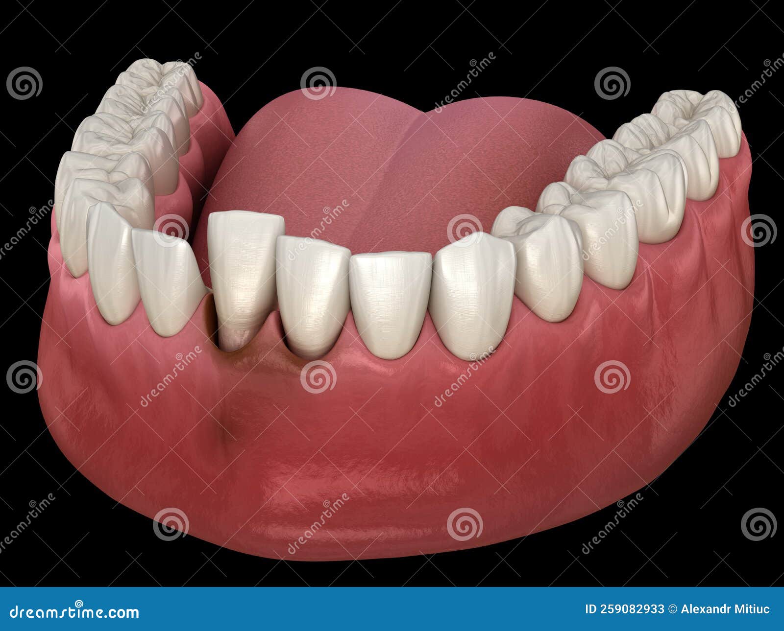 Tooth Dislocation after Trauma. Medically Accurate 3D Illustration ...