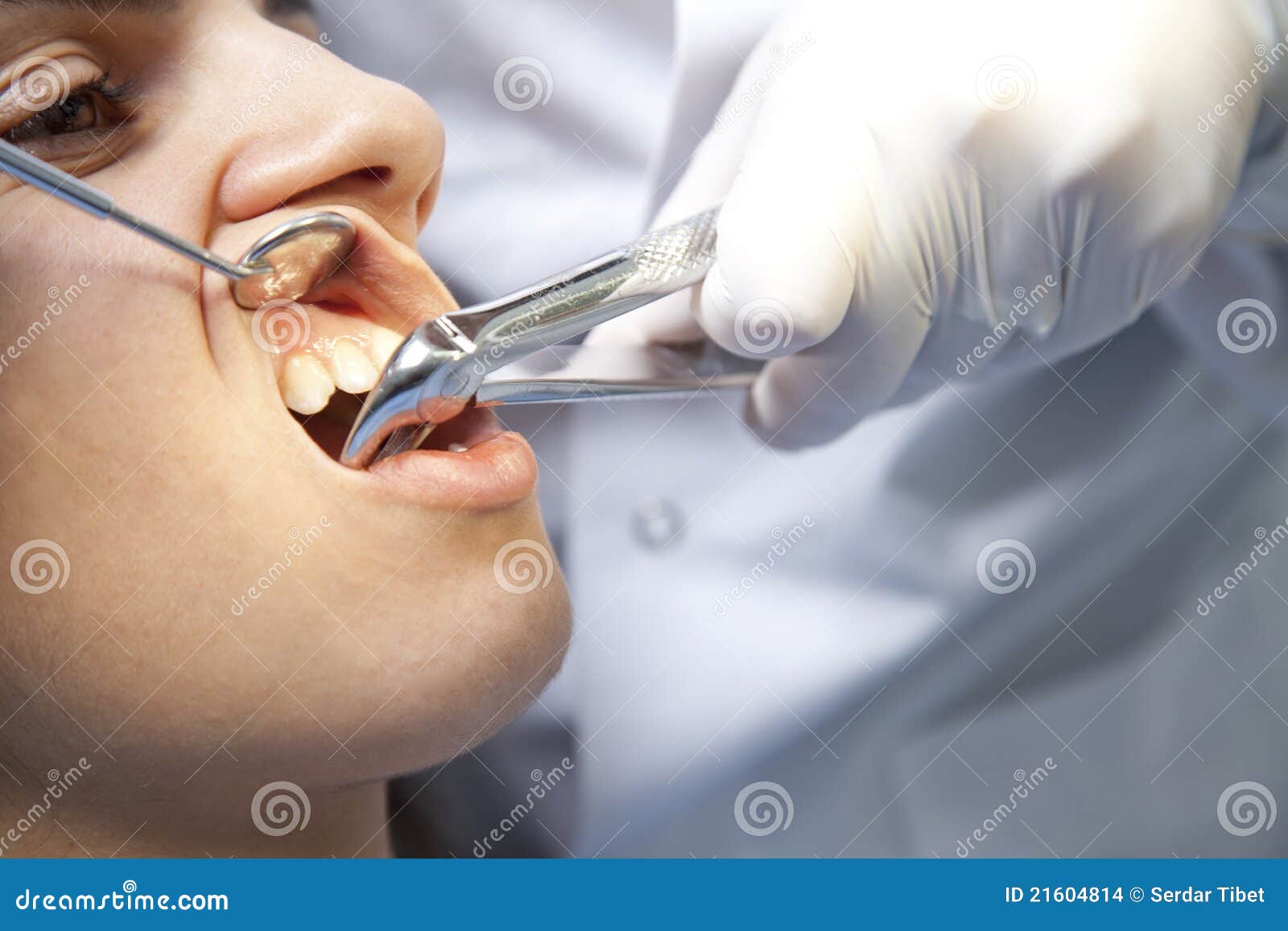 Tooth extraction stock photo. Image of extract, clinic - 21604814