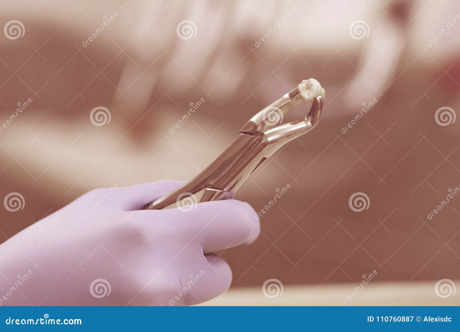 Tooth extraction stock image. Image of pliers, metal - 110760887