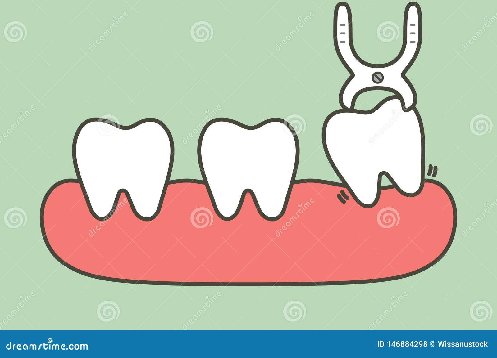 Tooth Extraction by Dental Tools To Remove Wisdom Tooth Stock Vector ...