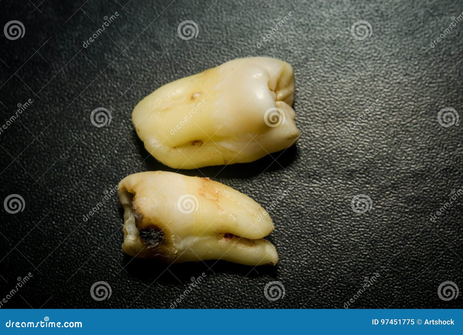 Tooth after Extraction stock image. Image of decay, wisdom - 97451775