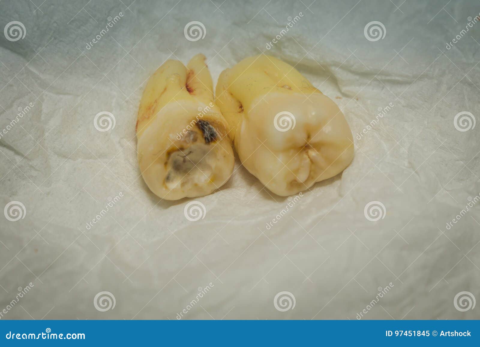 Tooth after Extraction stock image. Image of medical - 97451845