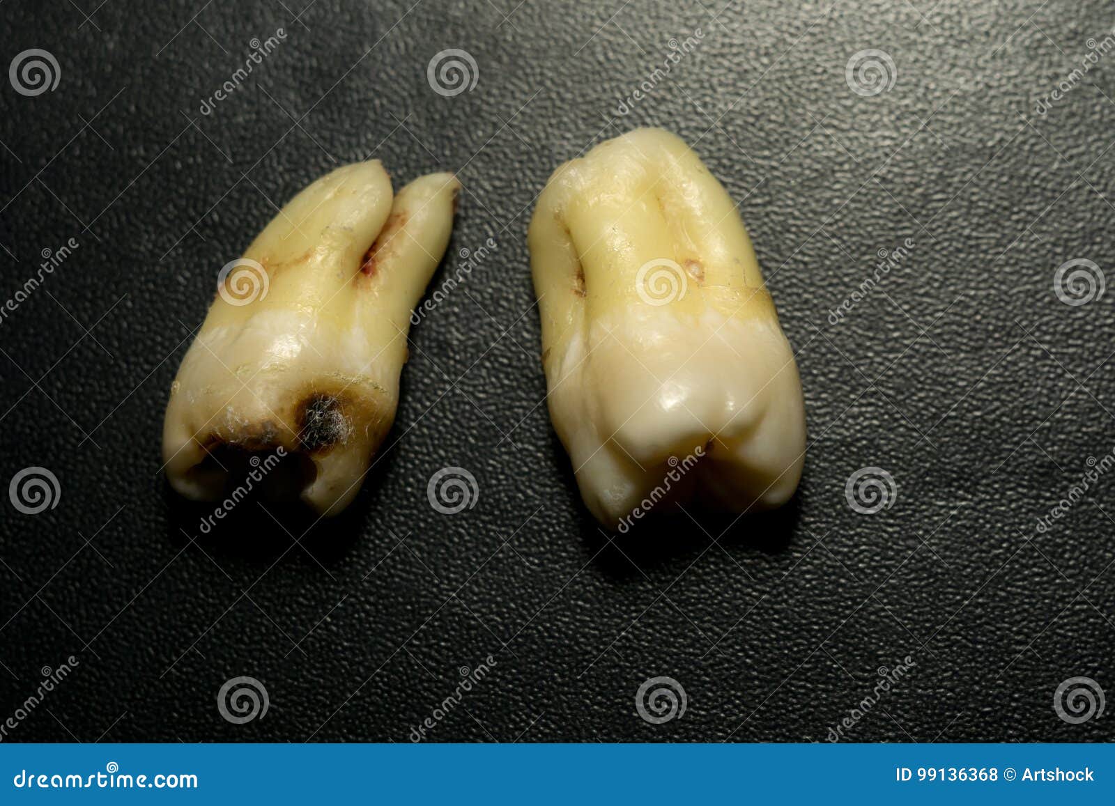 Tooth after Extraction stock photo. Image of root, toothache - 99136368
