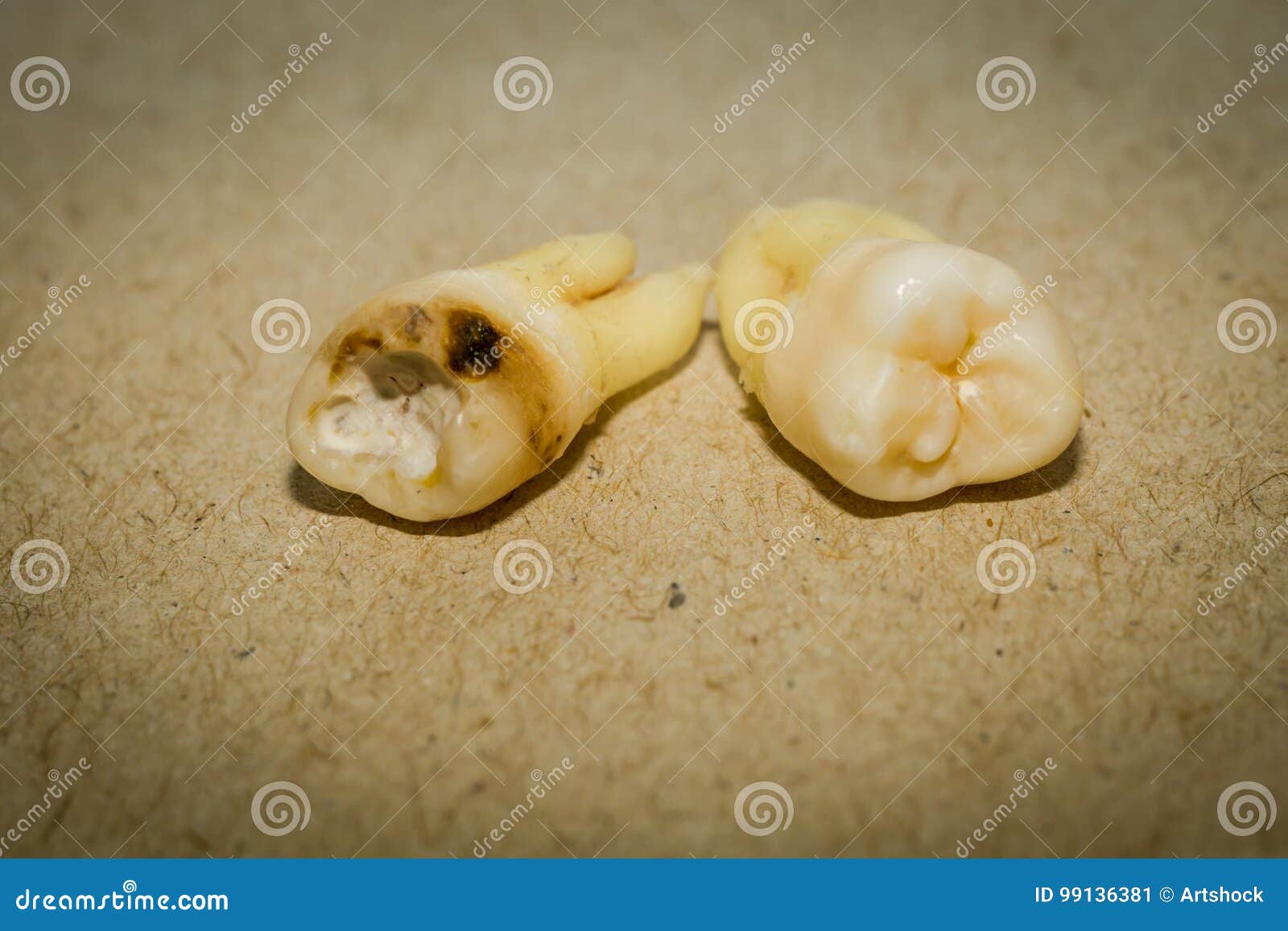 Tooth after Extraction stock image. Image of human, fallen - 99136381