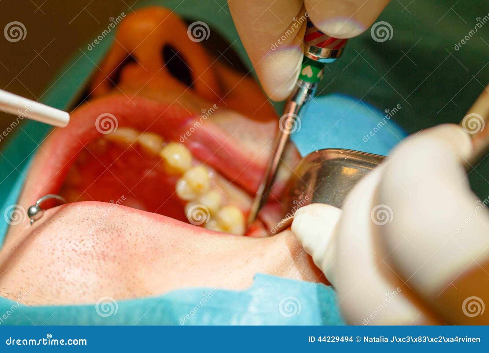 Tooth Extraction without Using Forceps Stock Photo - Image of human ...