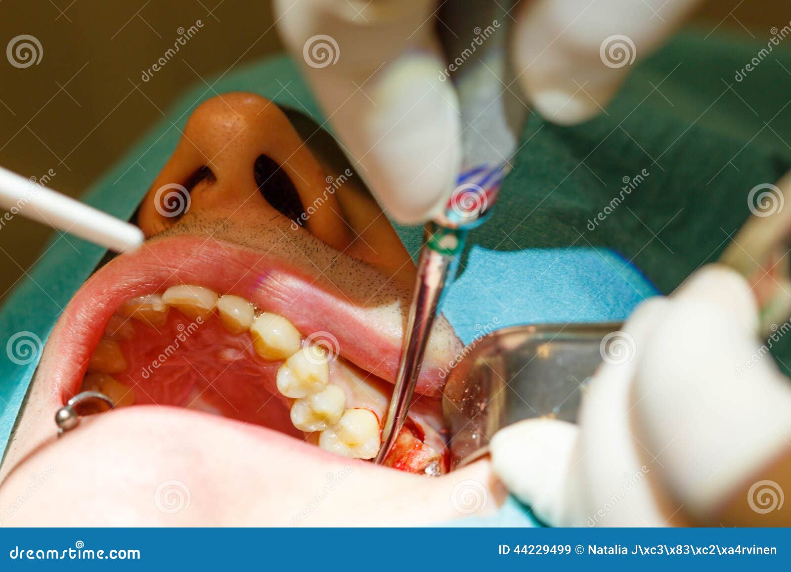 Tooth Extraction without Using Forceps Stock Image - Image of surgery ...