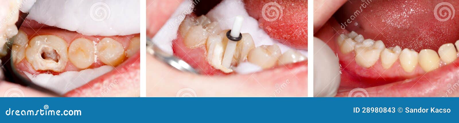 Tooth filling by dentist stock image. Image of healthcare - 28980843