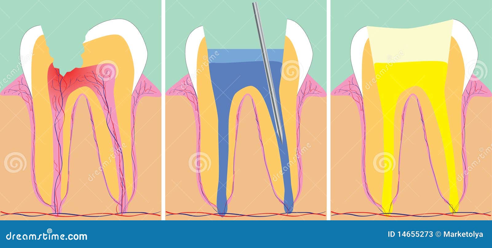 Tooth fillings stock vector. Illustration of elderly - 14655273