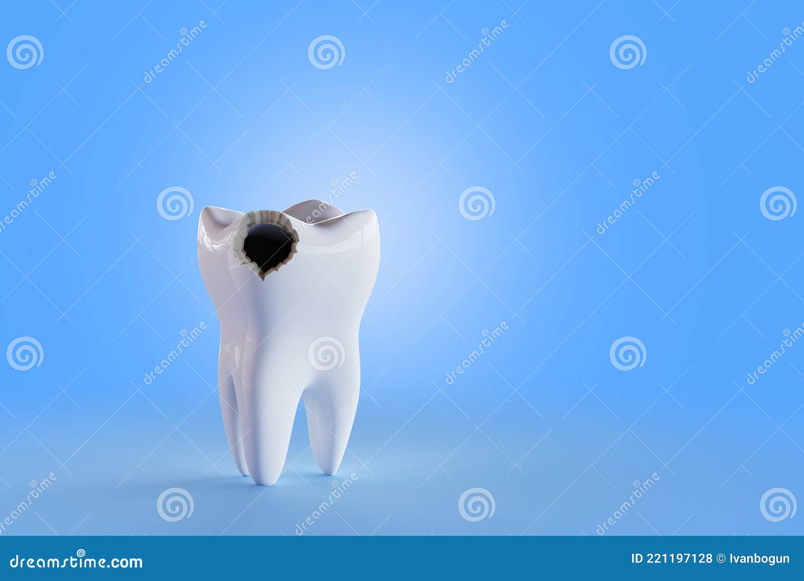 Tooth With Hole. Sick Tooth. Caries And Pulpitis Toothache Vector ...