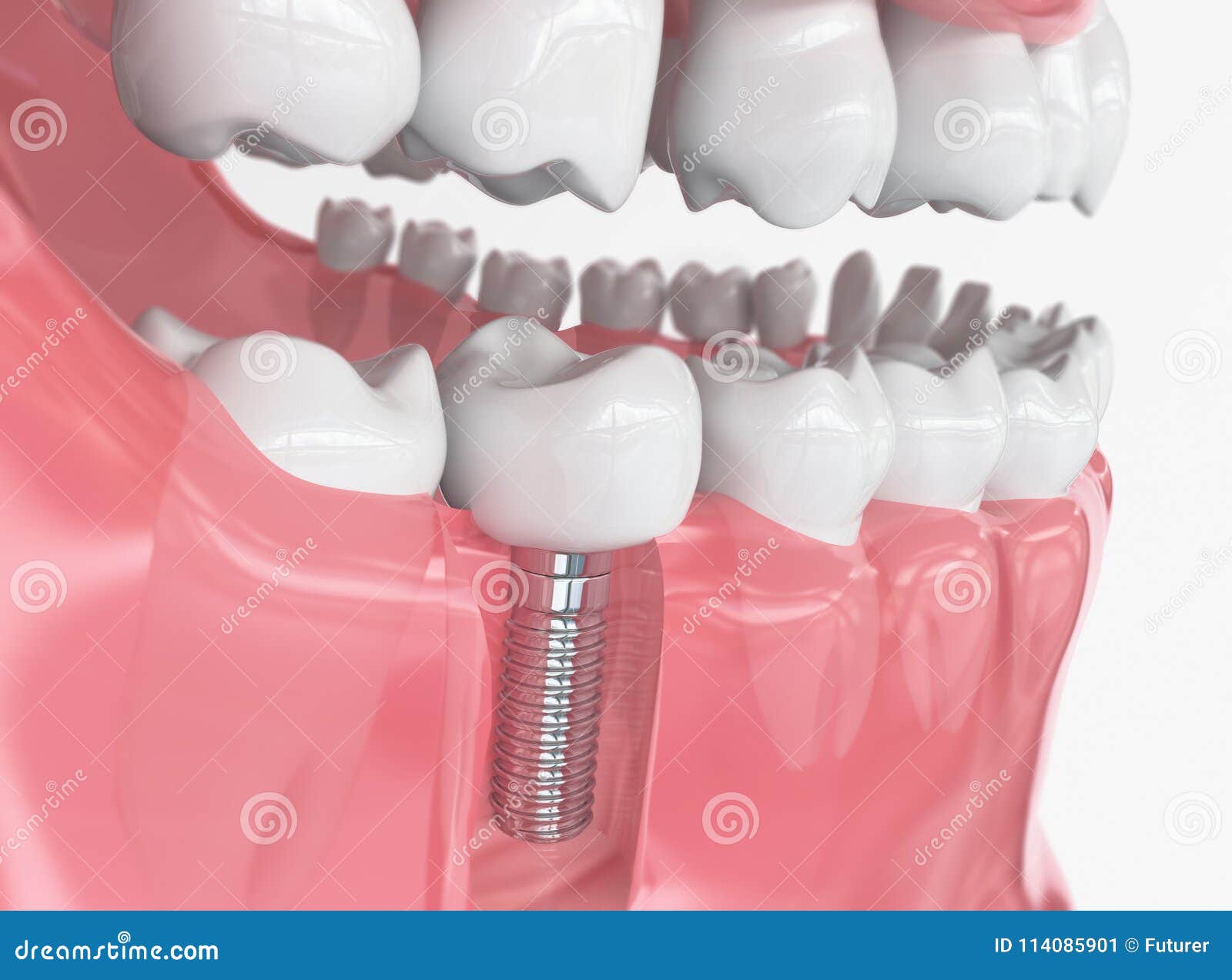 Tooth Human Implant - 3D Rendering Stock Image - Image of equipment ...