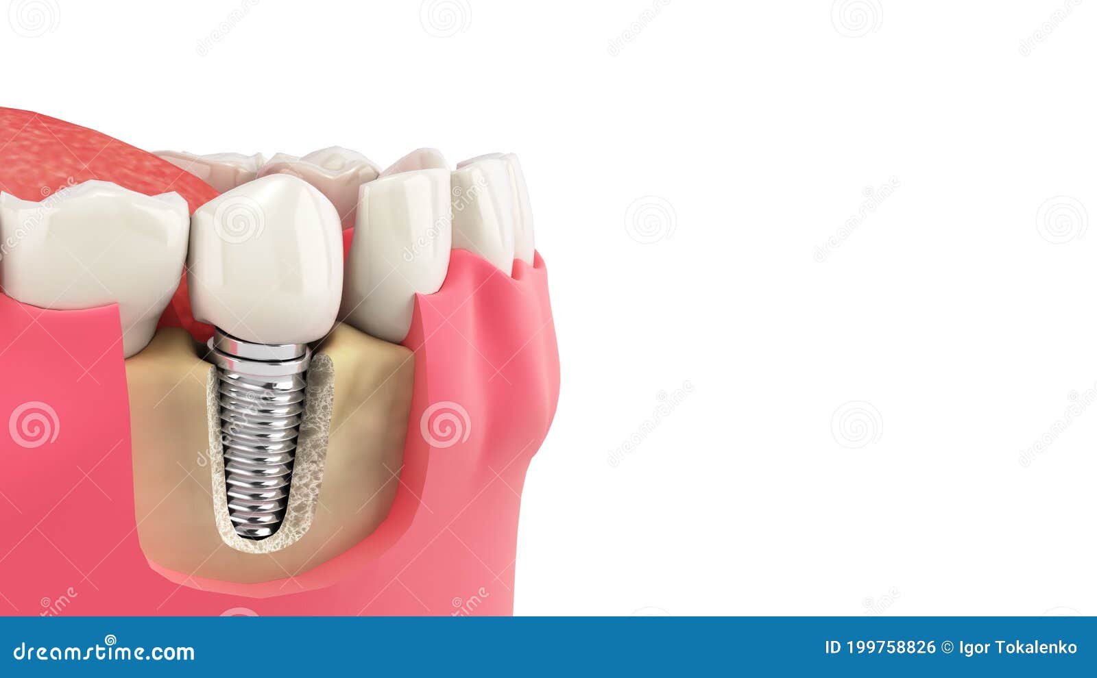 Tooth Human Single Implant Dental Concept Human Teeth or Dentures 3d ...