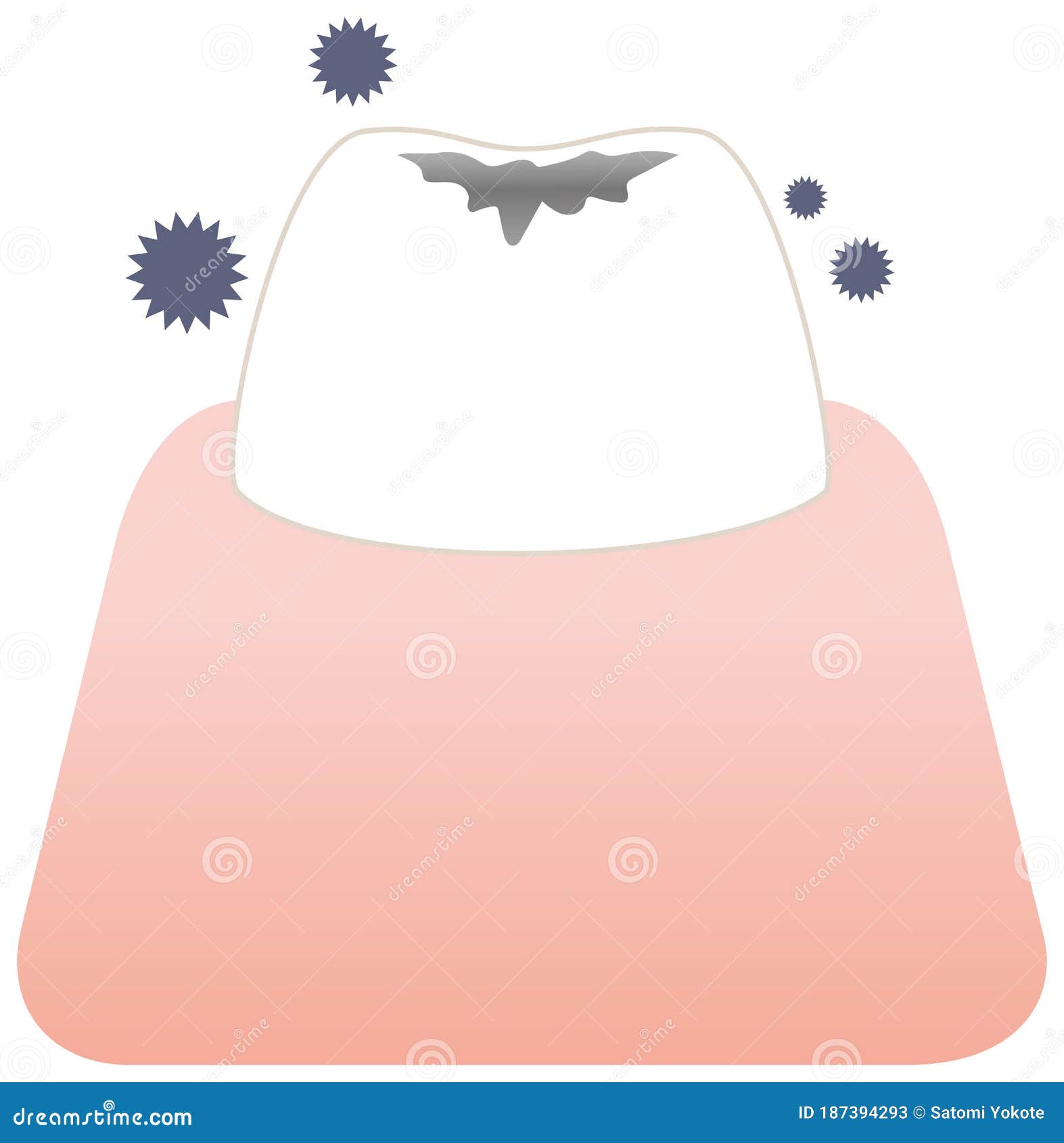 Tooth Illustration with Cariogenic Bacteria Stock Vector - Illustration ...