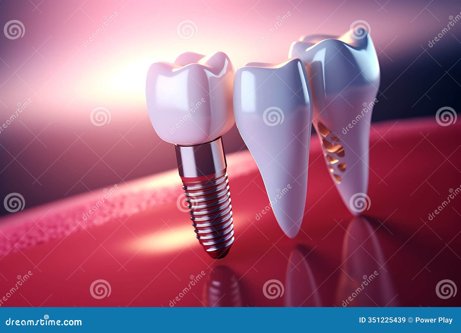 Tooth Implant on a Blue and Pink Background. 3d Illustration Stock ...