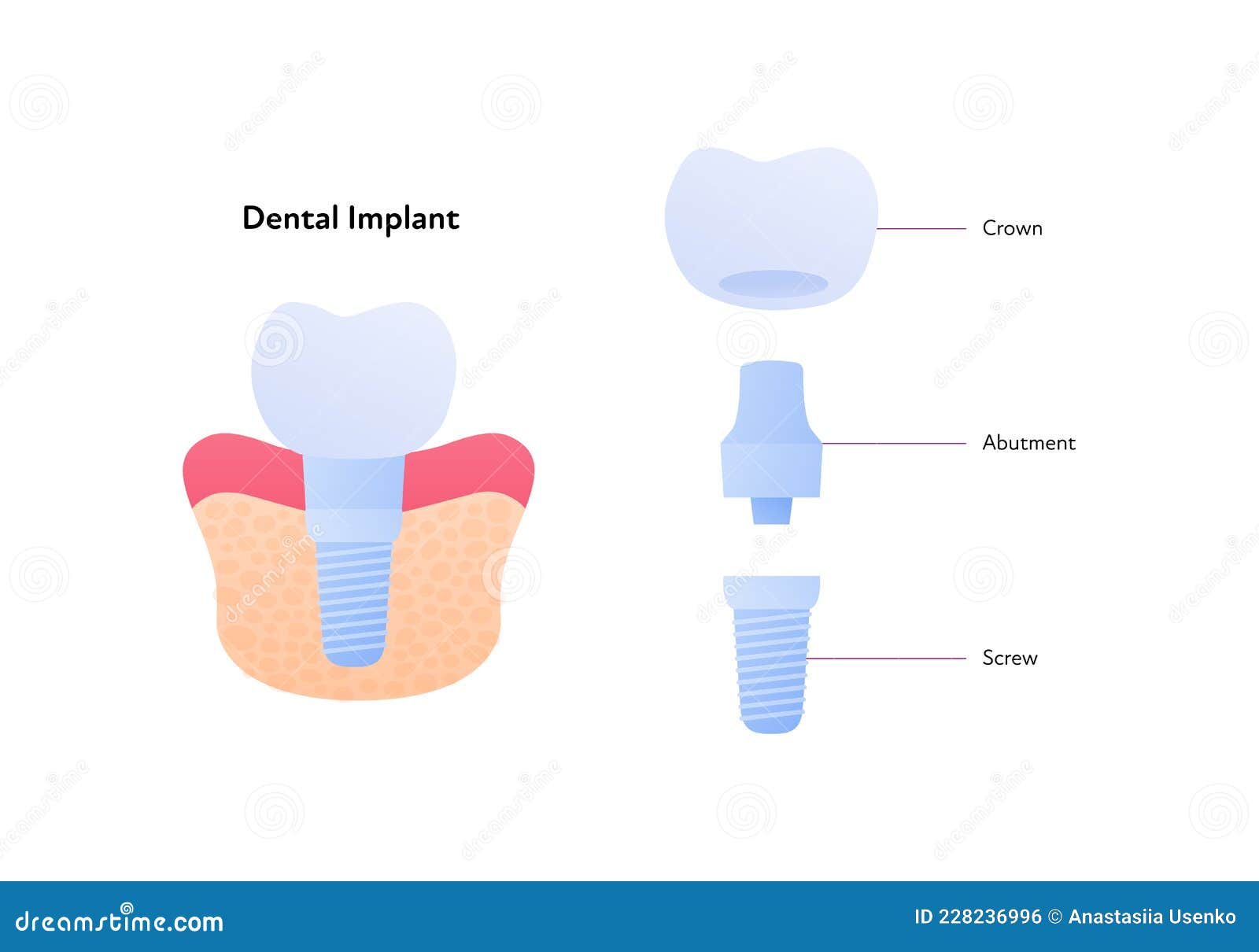 Tooth Implant Chart. Vector Biomedical Illustration. Cross Section ...
