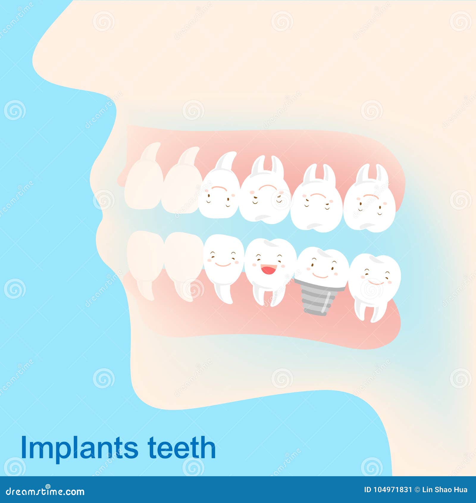 Cartoon implants teeth stock vector. Illustration of milk - 104971831