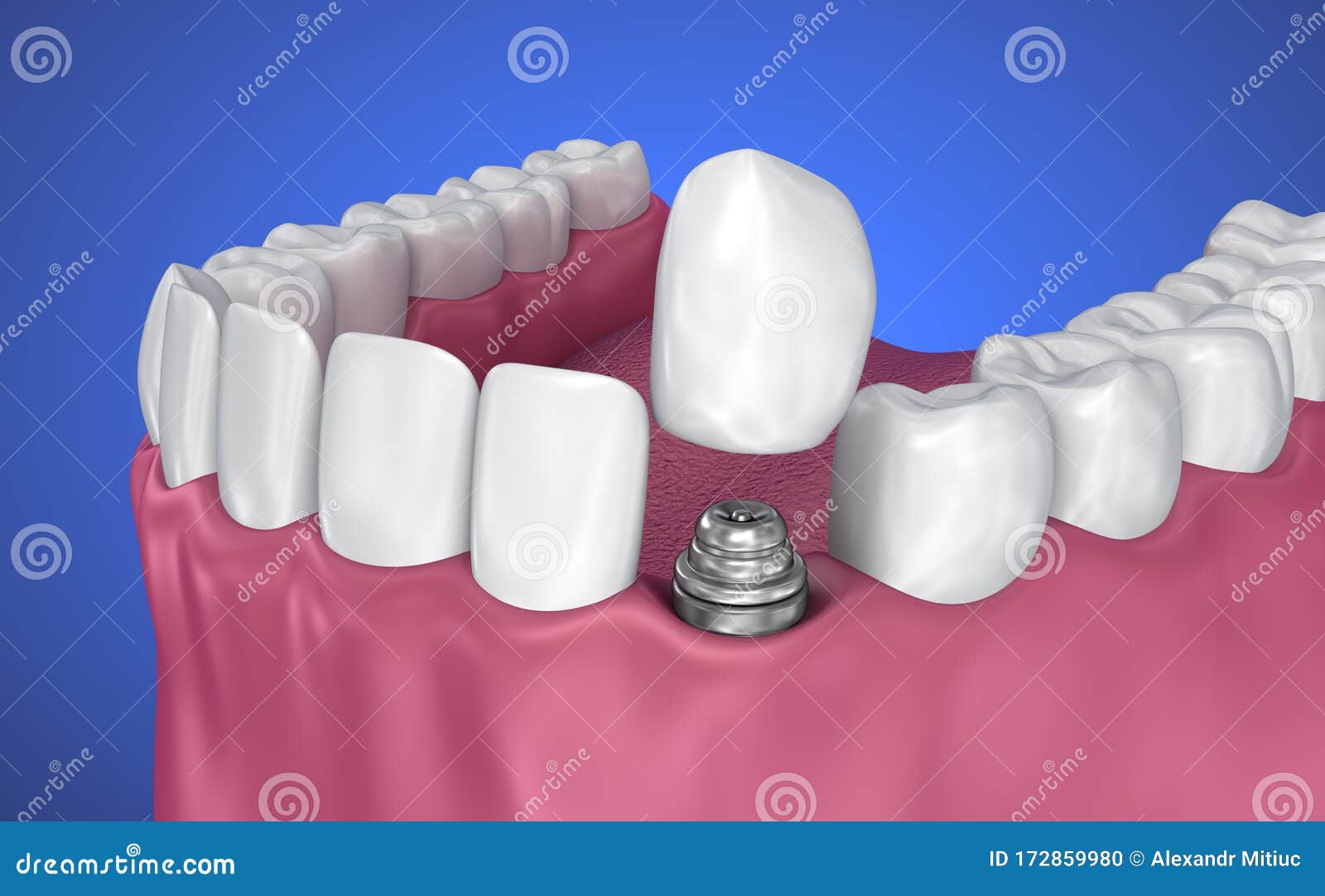 Tooth Implant and Crown Installation Process. Medically Accurate Stock ...