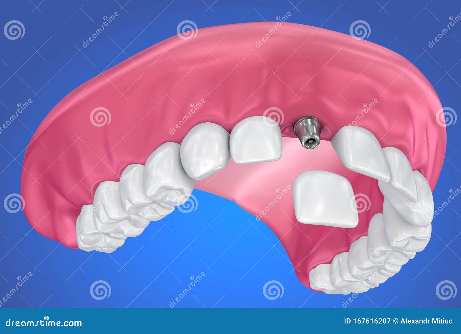 Tooth Implant and Crown Installation Process Stock Illustration ...