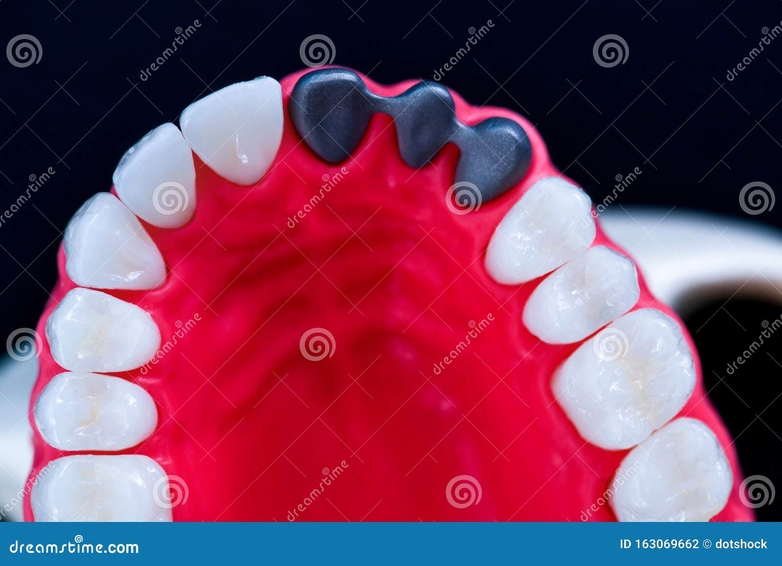 Tooth Implant and Crown Installation Process Stock Photo - Image of ...