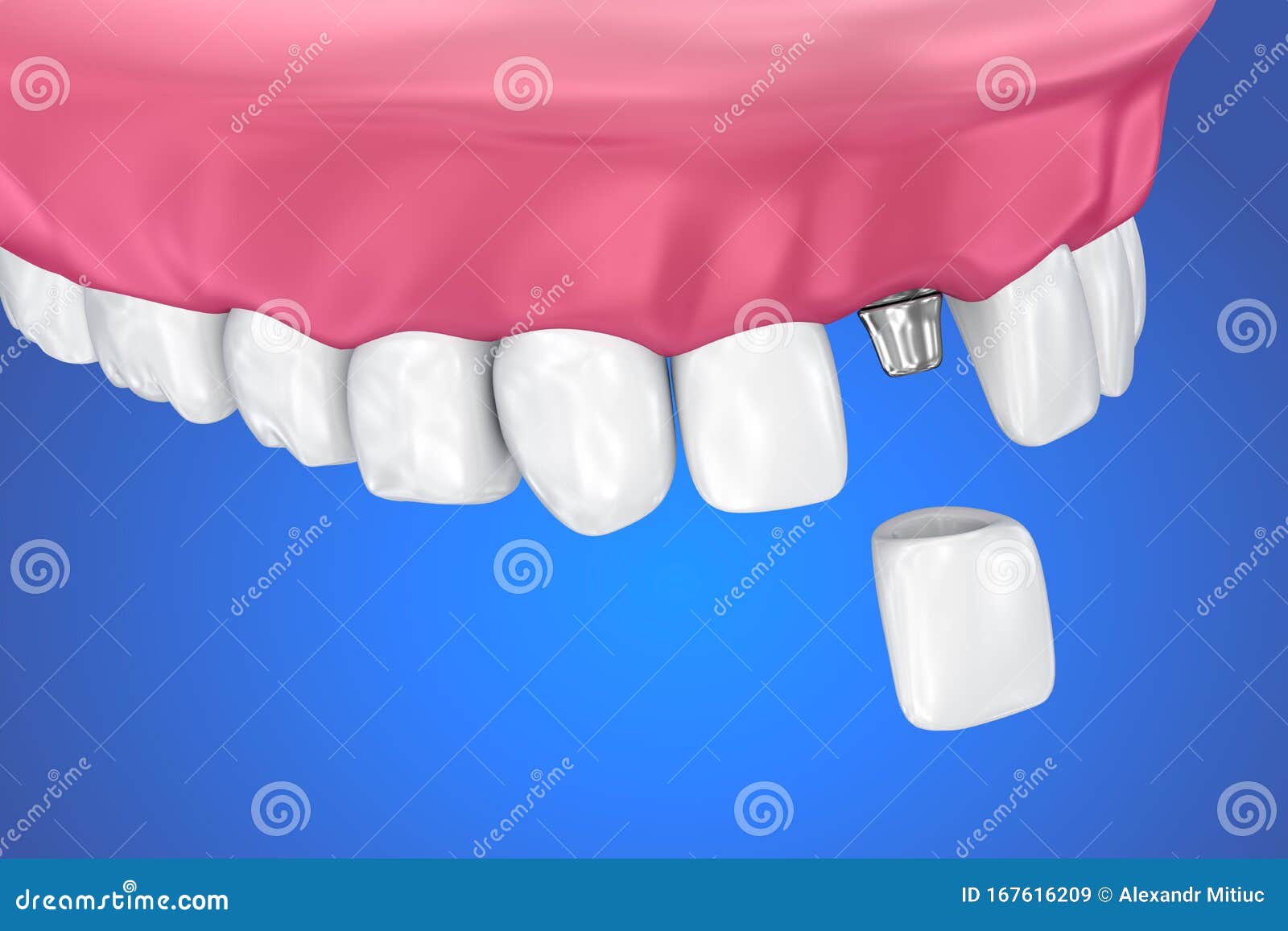 Tooth Implant and Crown Installation Process Stock Illustration ...