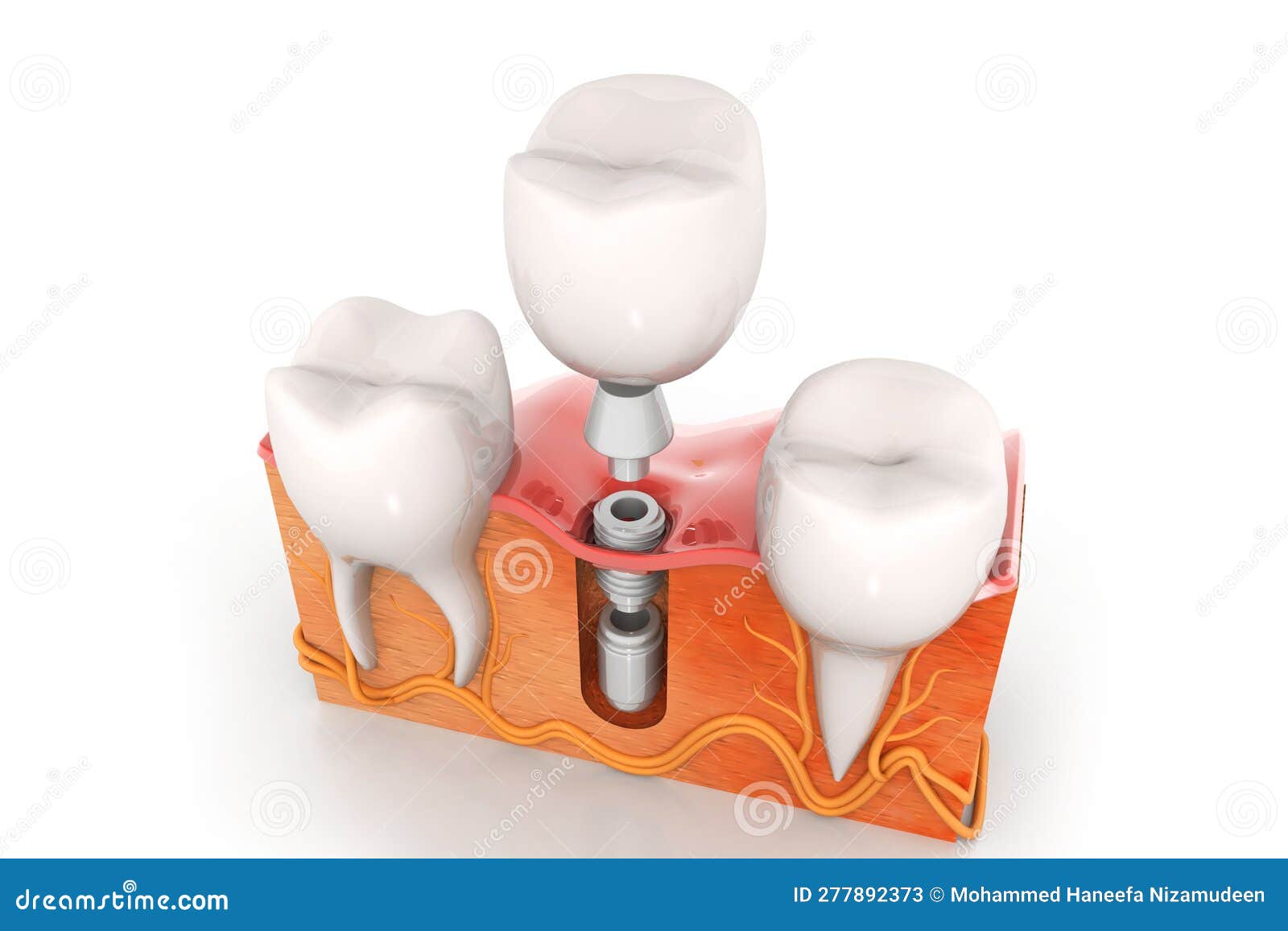 Tooth Implant Instalation Process Stock Illustration - Illustration of ...