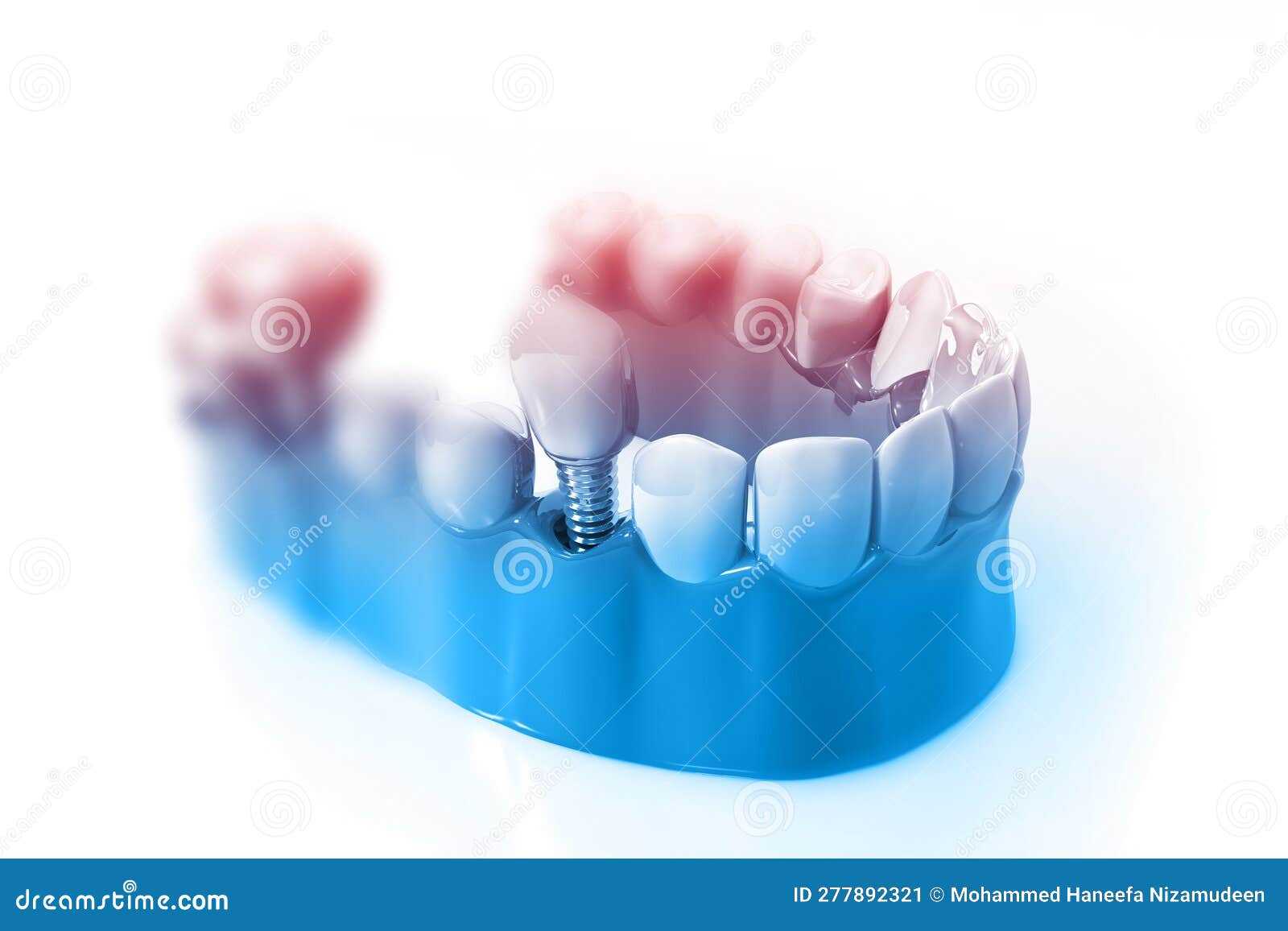 Tooth Implant Instalation Process Stock Illustration - Illustration of ...