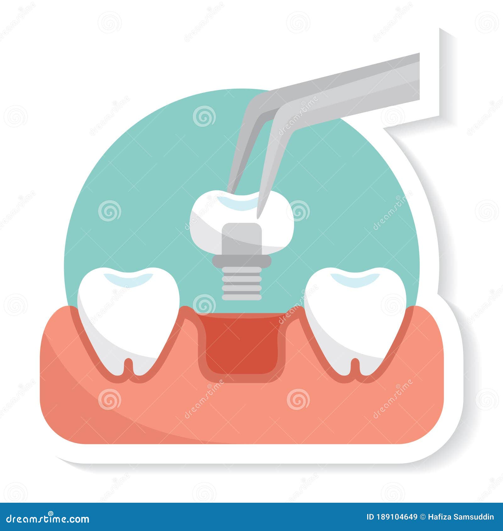 Tooth Implant. Vector Illustration Decorative Design Stock Vector ...